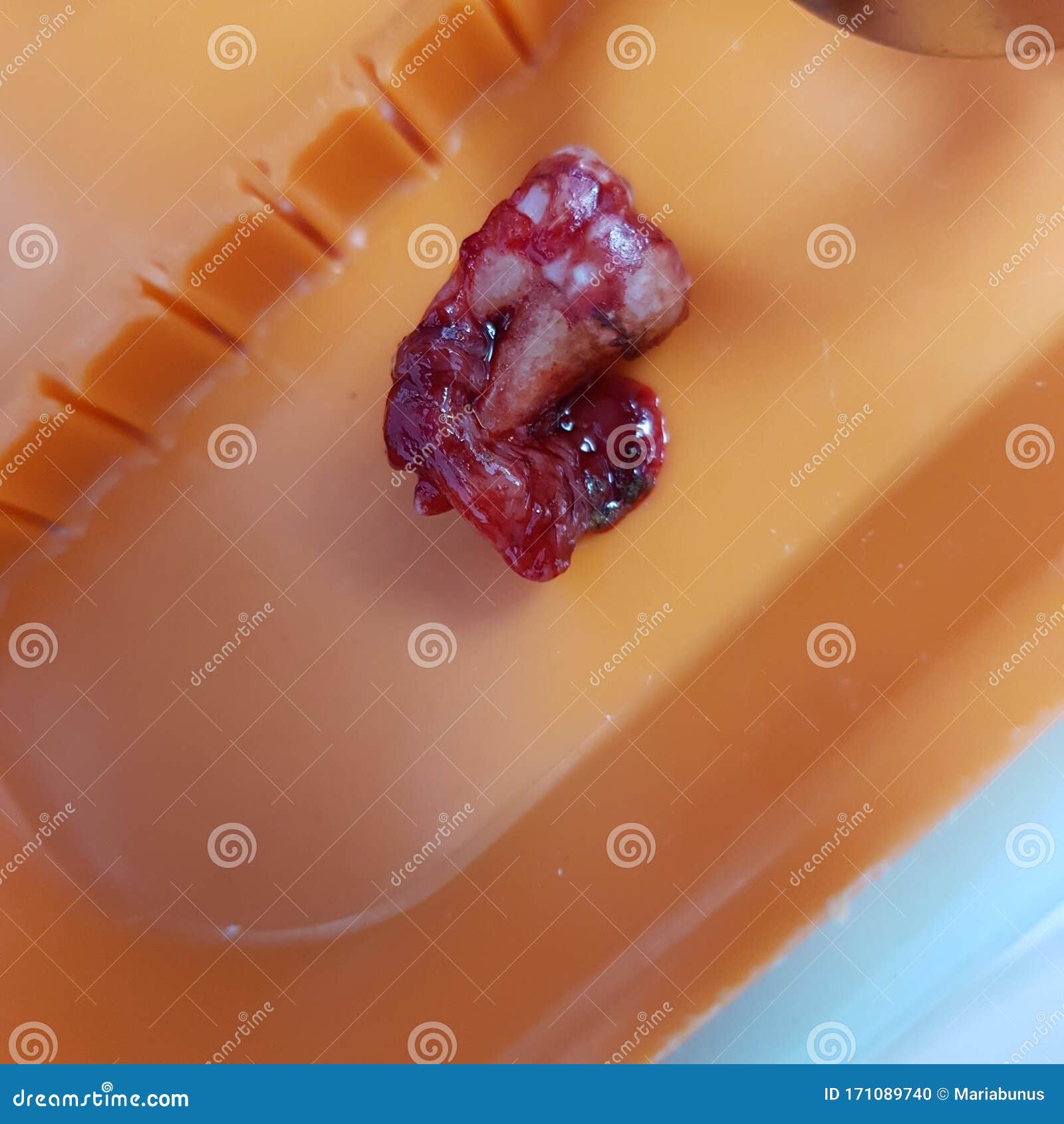 Bloody Granulous Molar stock photo. Image of decayed - 171089740