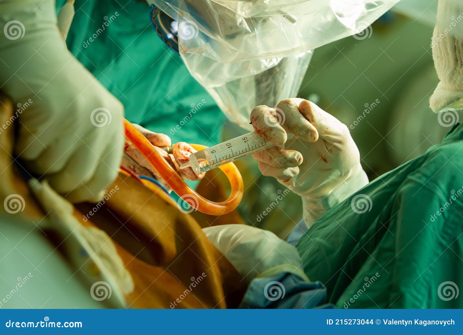Bloody Hands of Surgeons during Surgery Stock Photo - Image of scalpel ...