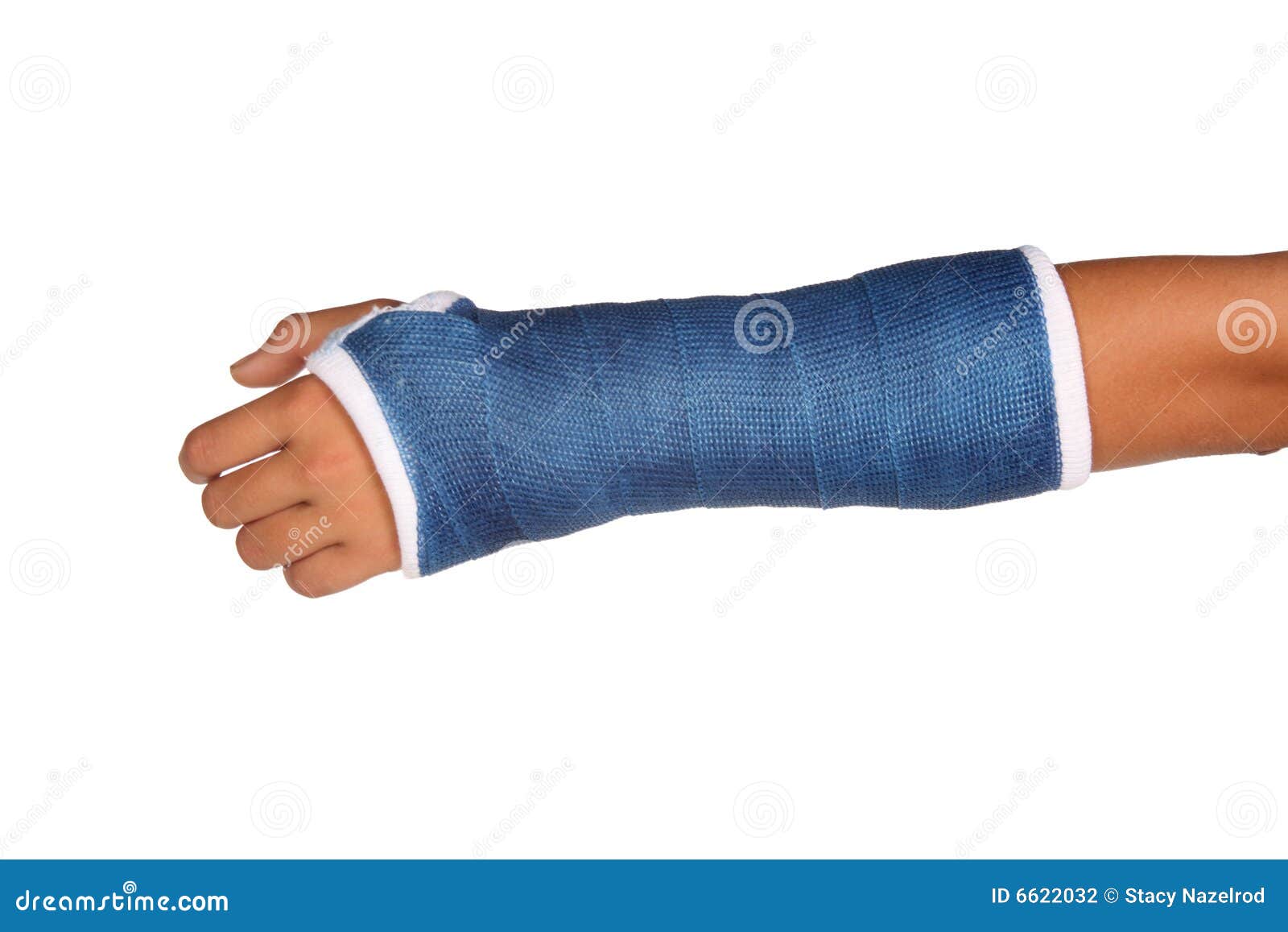 Blue cast stock photo. Image of accident, fracture, human - 6622032