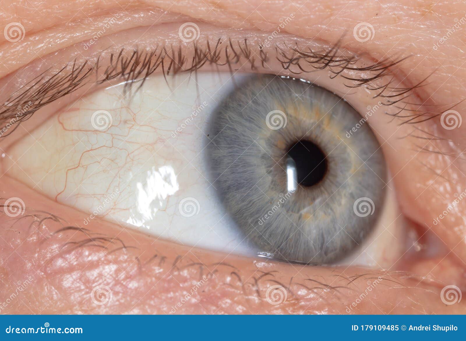 Blue Eye on the Man`s Face. Stock Image - Image of mucus, blue: 179109485