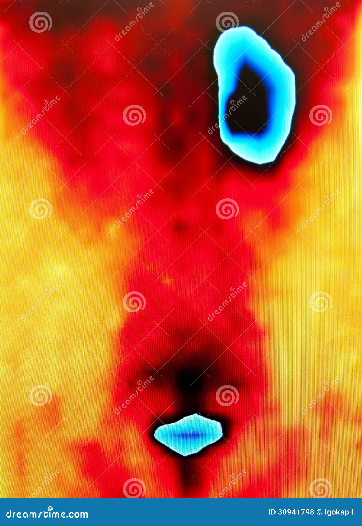 Normal Renal Flow,nuclear Medicine Stock Image | CartoonDealer.com ...