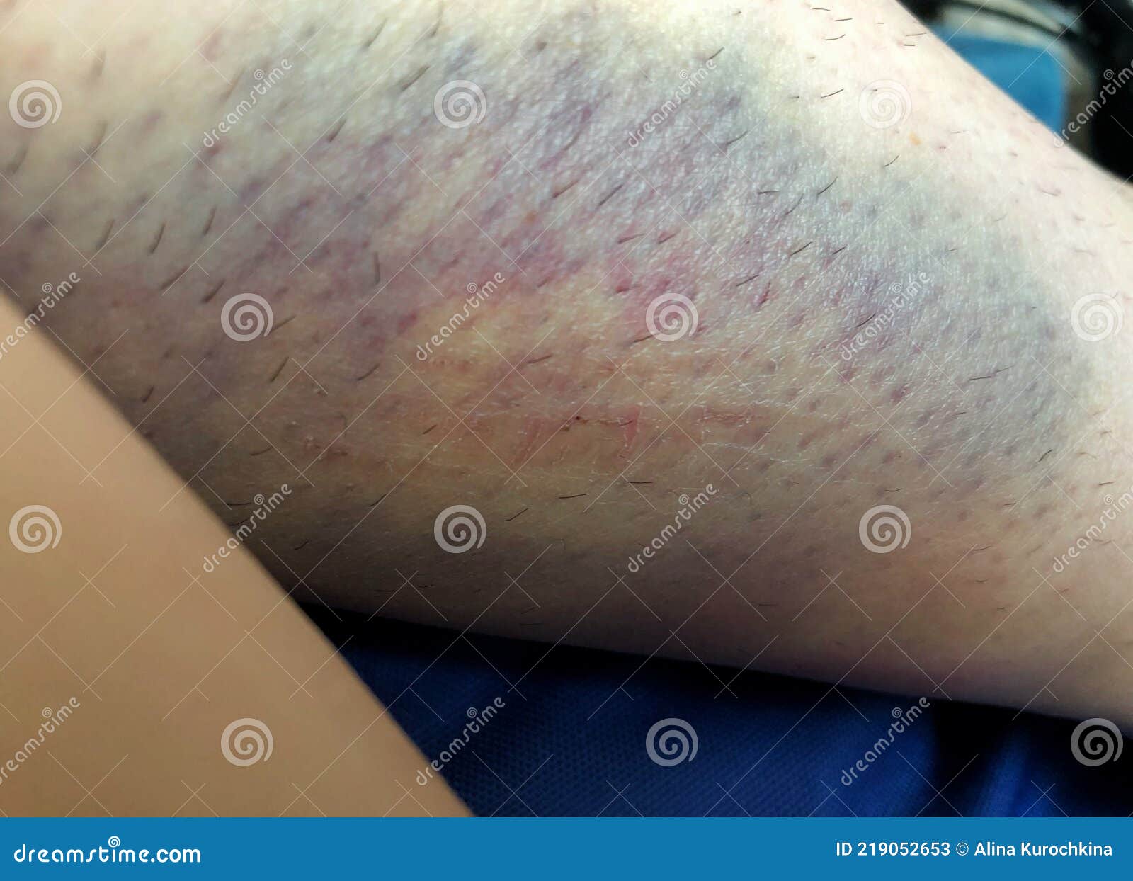 Blue-purple Bruise Close Up on the Leg Stock Image - Image of beaten ...