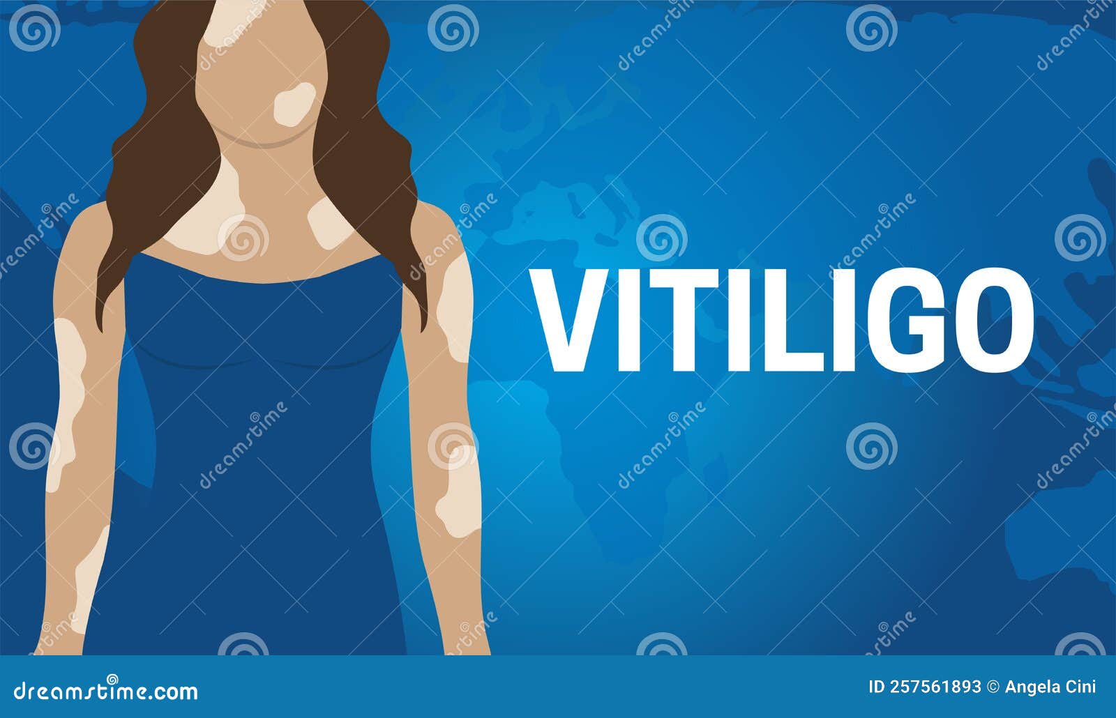 Vitiligo On Skin Layer Anatomy Cartoon Vector | CartoonDealer.com ...