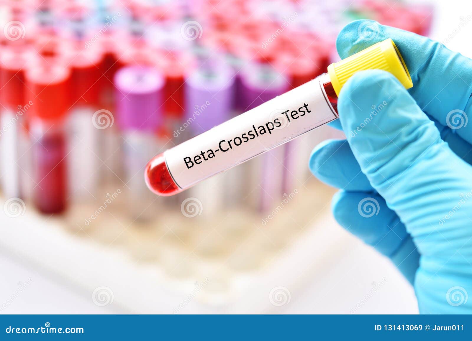 Blutprobe Für Beta--crosslaps Oder Beta-CTx Test Stockbild - Bild von ...