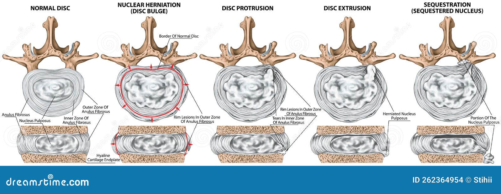 Disc Herniation Or Spine Nerve Compression Vs Healthy Anatomy Outline ...