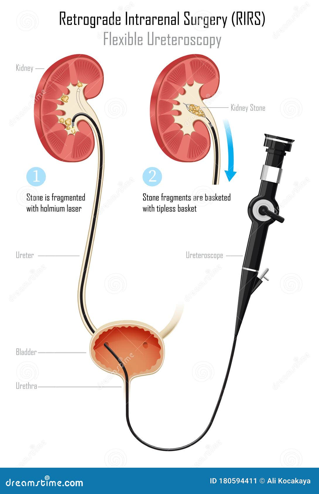Retrograde Intrarenal Surgery, RIRS Stock Vector - Illustration of ...