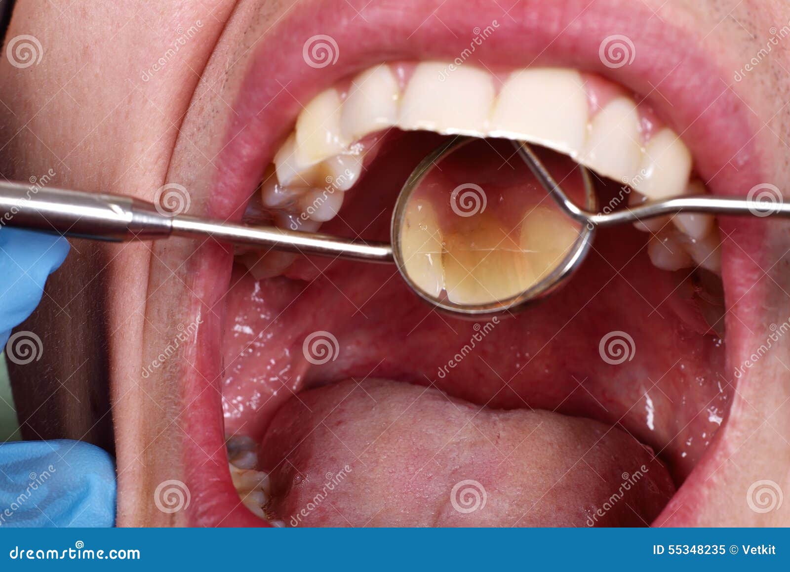 Boca abierta del paciente imagen de archivo. Imagen de saliva - 55348235