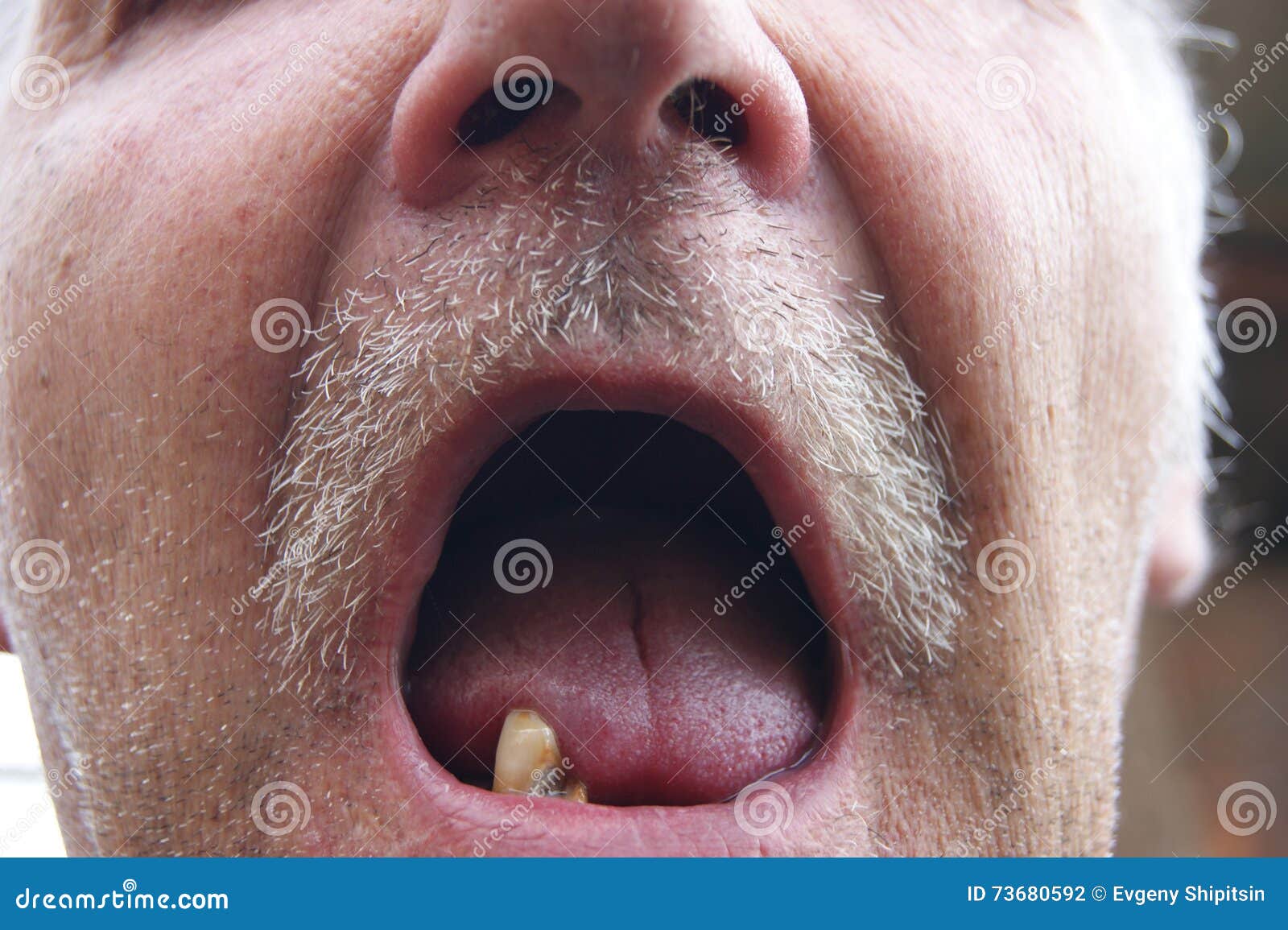 Boca com dentes podres foto de stock. Imagem de soltar - 73680592