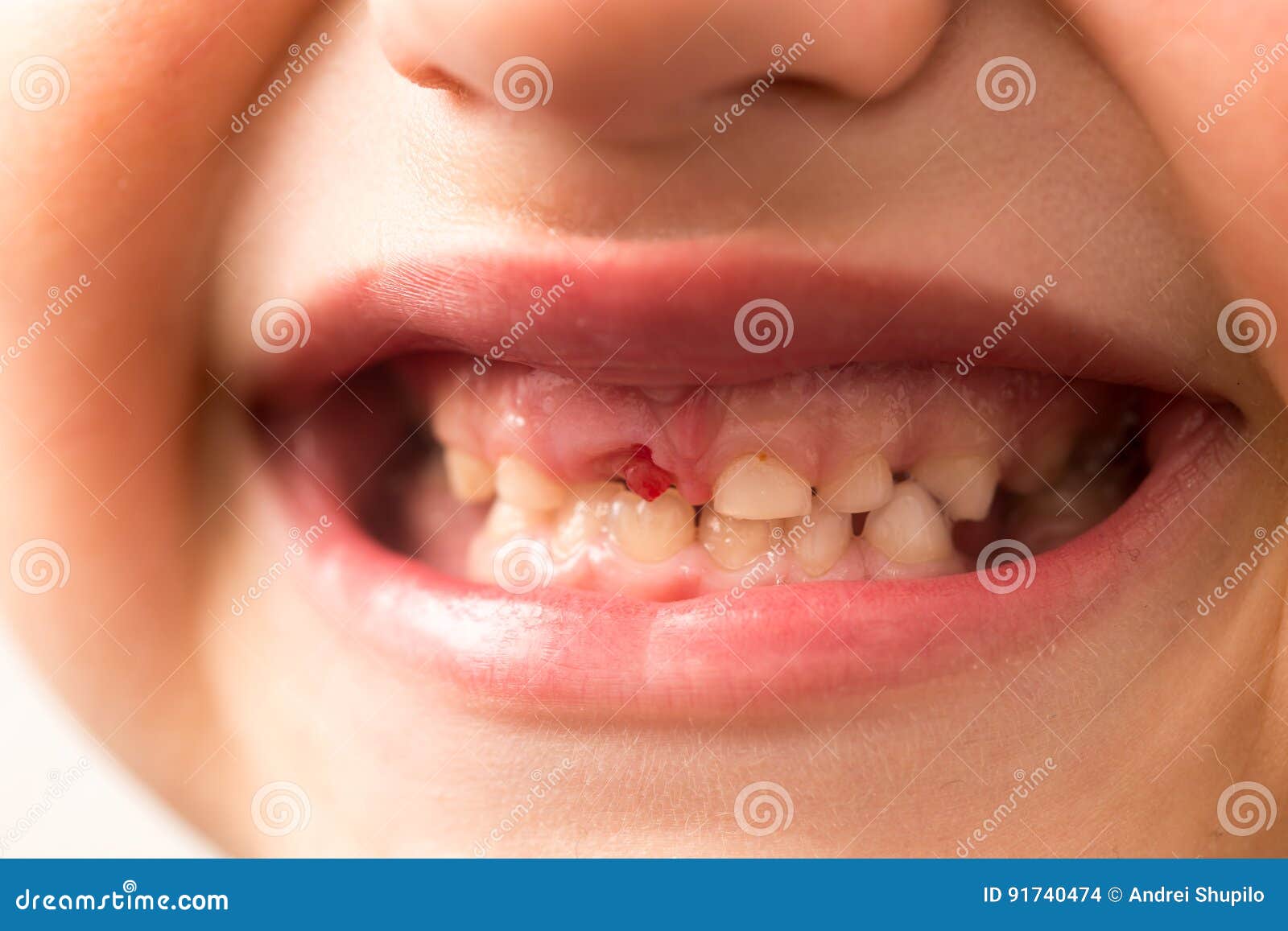 A Boca De Um Menino Sem Um Dente Foto de Stock - Imagem de dentes ...