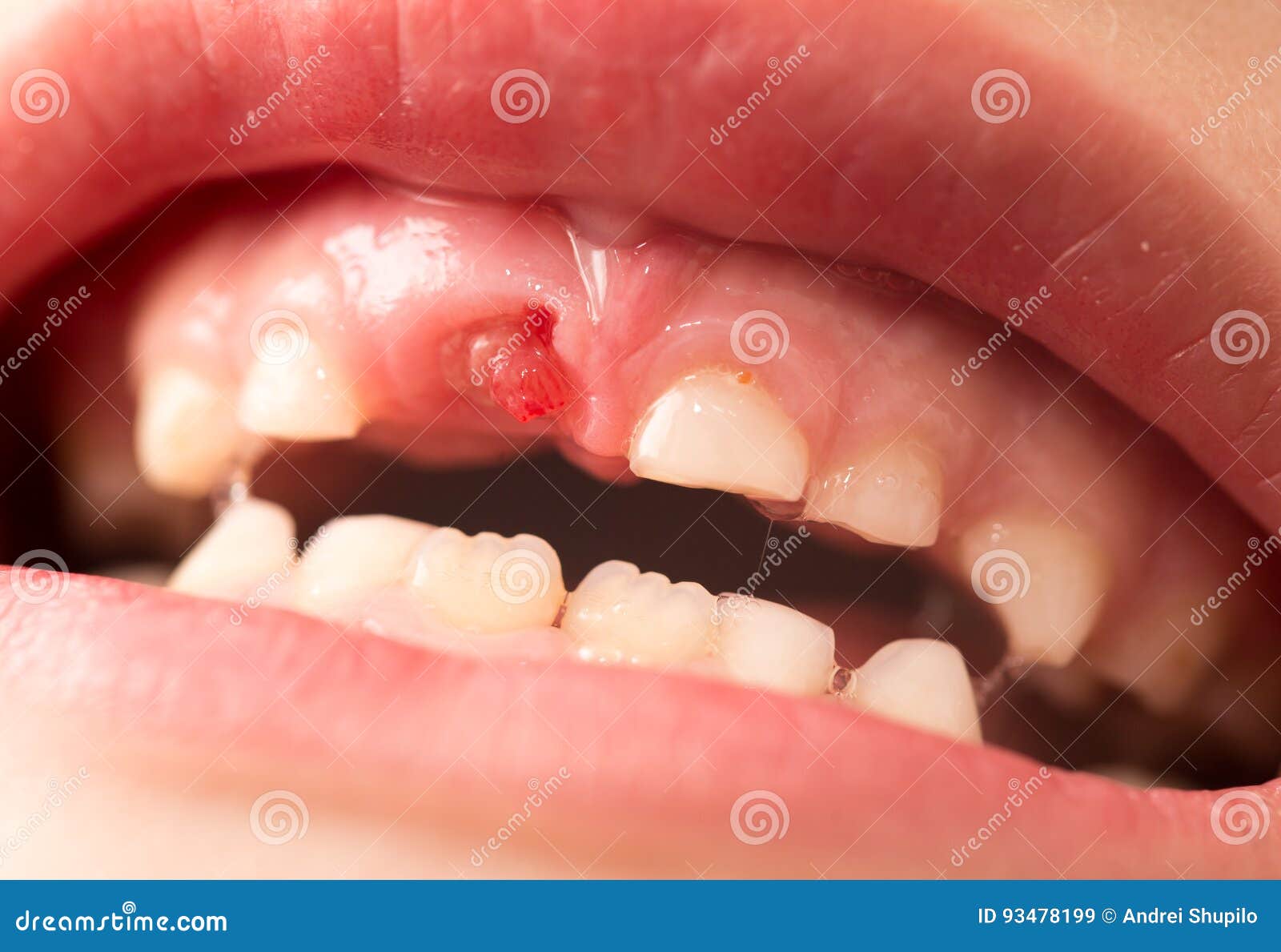 A Boca De Um Menino Sem Um Dente Imagem de Stock - Imagem de cara ...