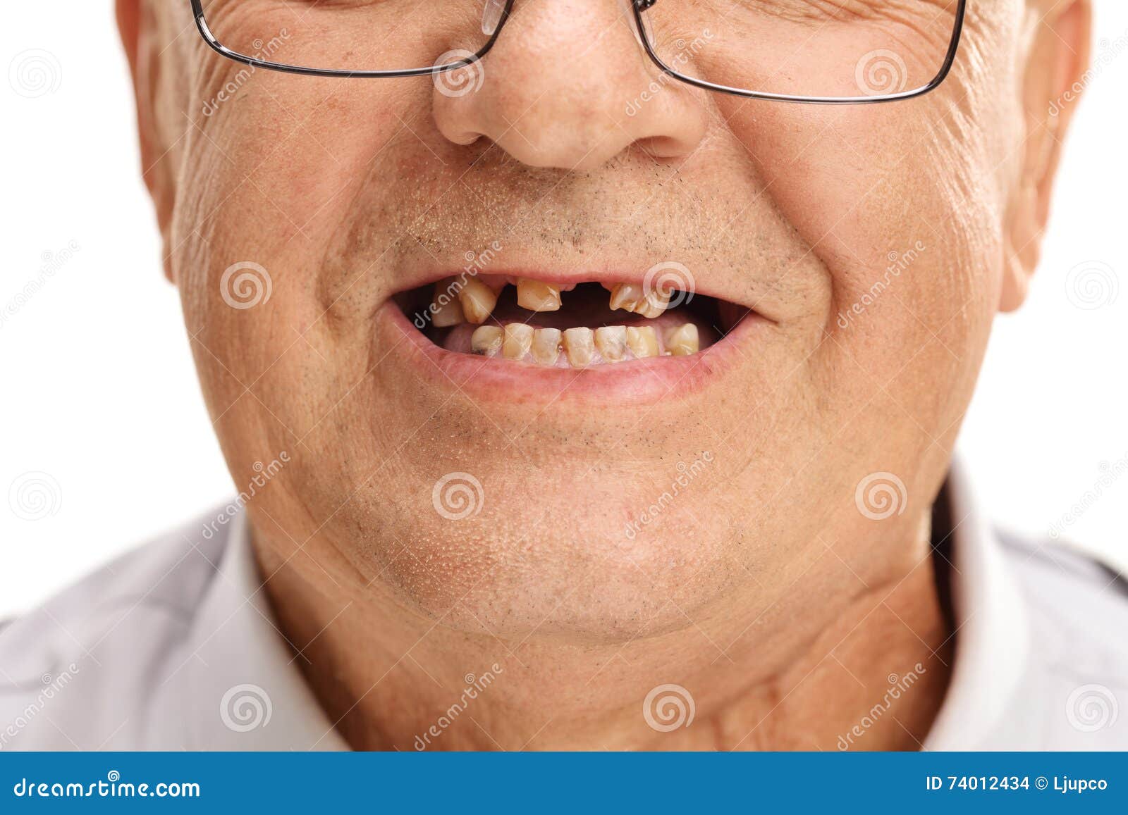 Bocca Di Un Anziano Con I Denti Rotti Fotografia Stock - Immagine di ...