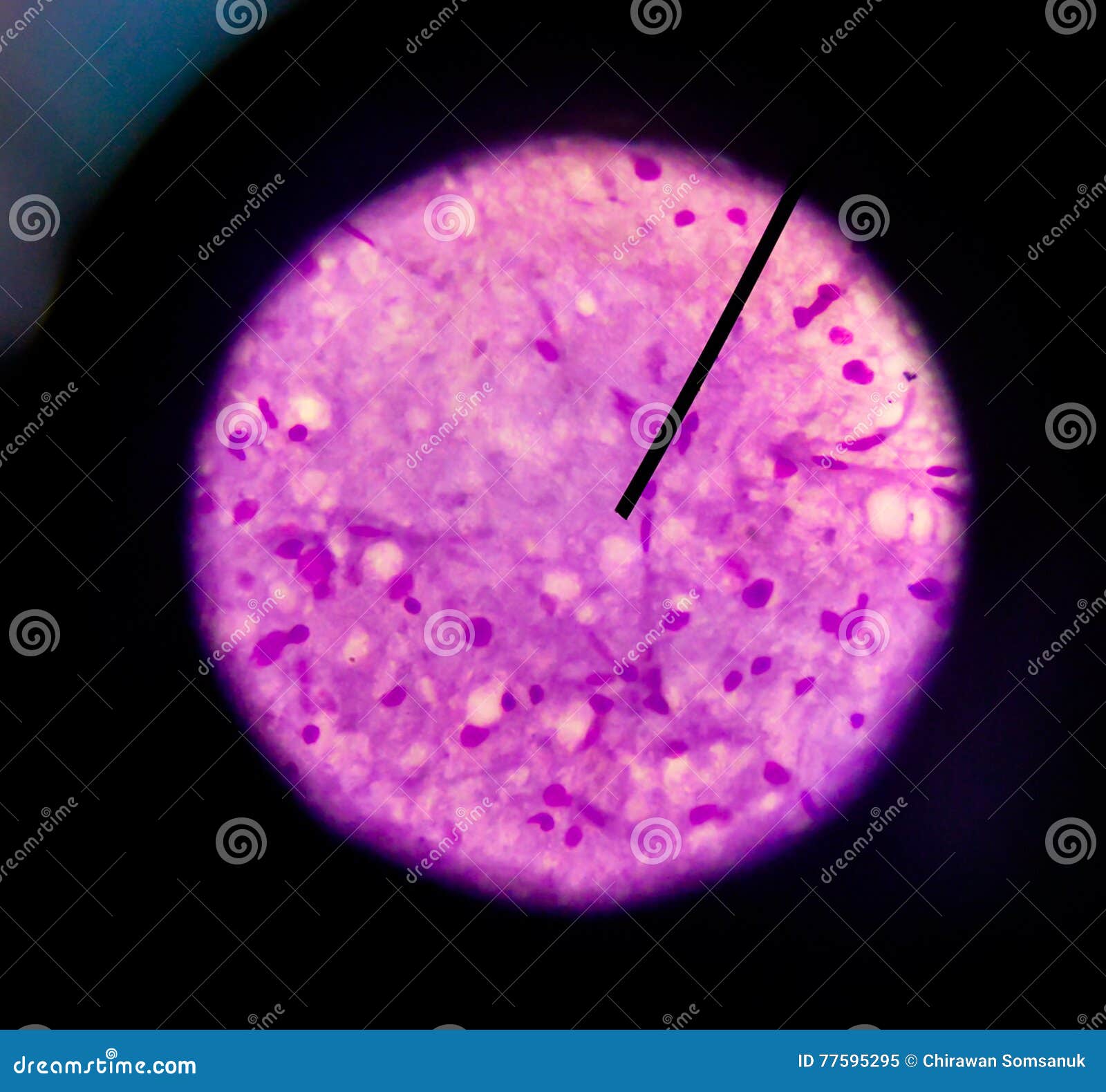 Cells Of A Human Thyroid Gland With Swelling Under A Microscope Stock ...