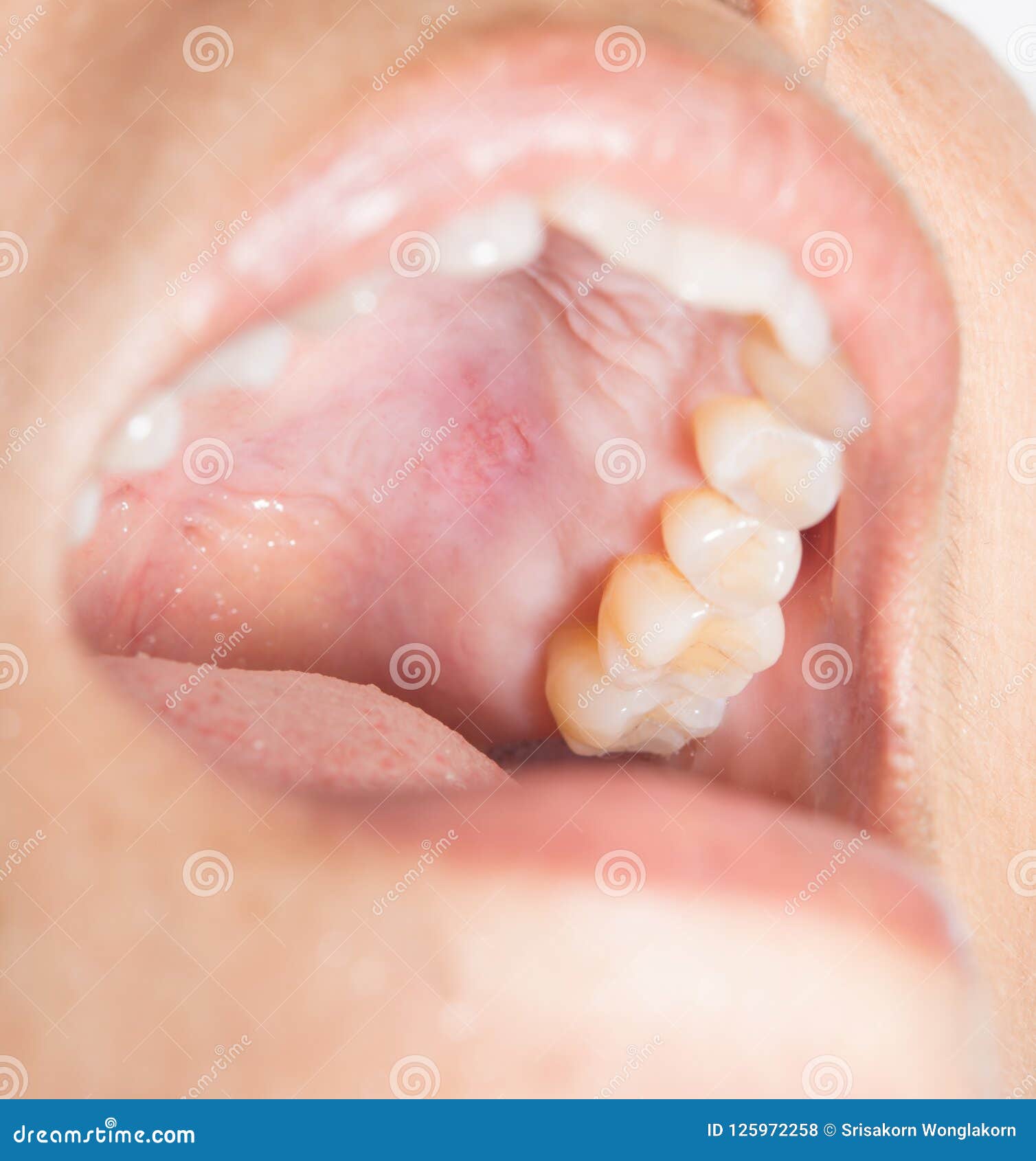 Bolhas na boca infec??o foto de stock. Imagem de bolha - 125972258