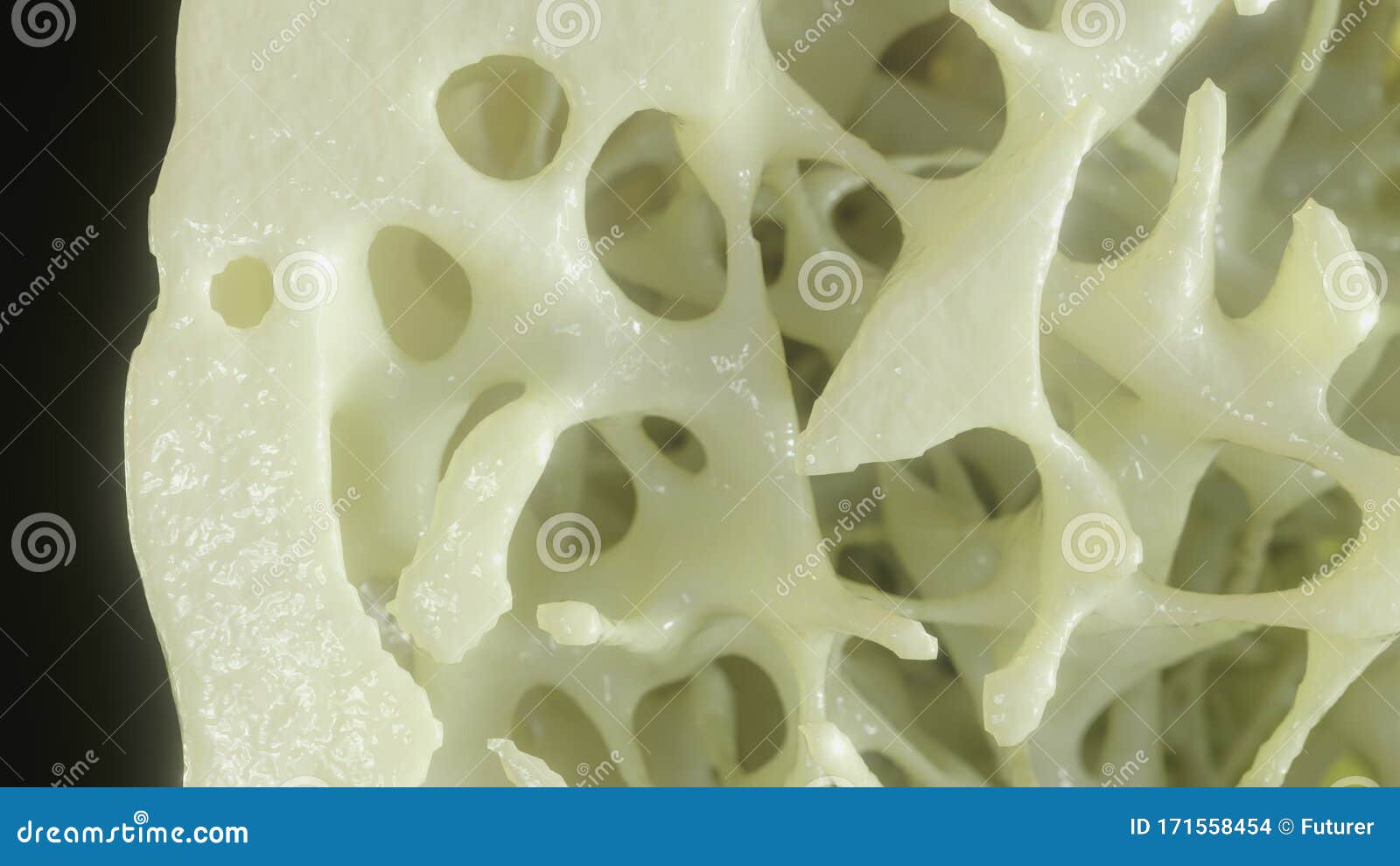 Bone Affected With Osteoporosis Cross Section 3d Rendering Stock