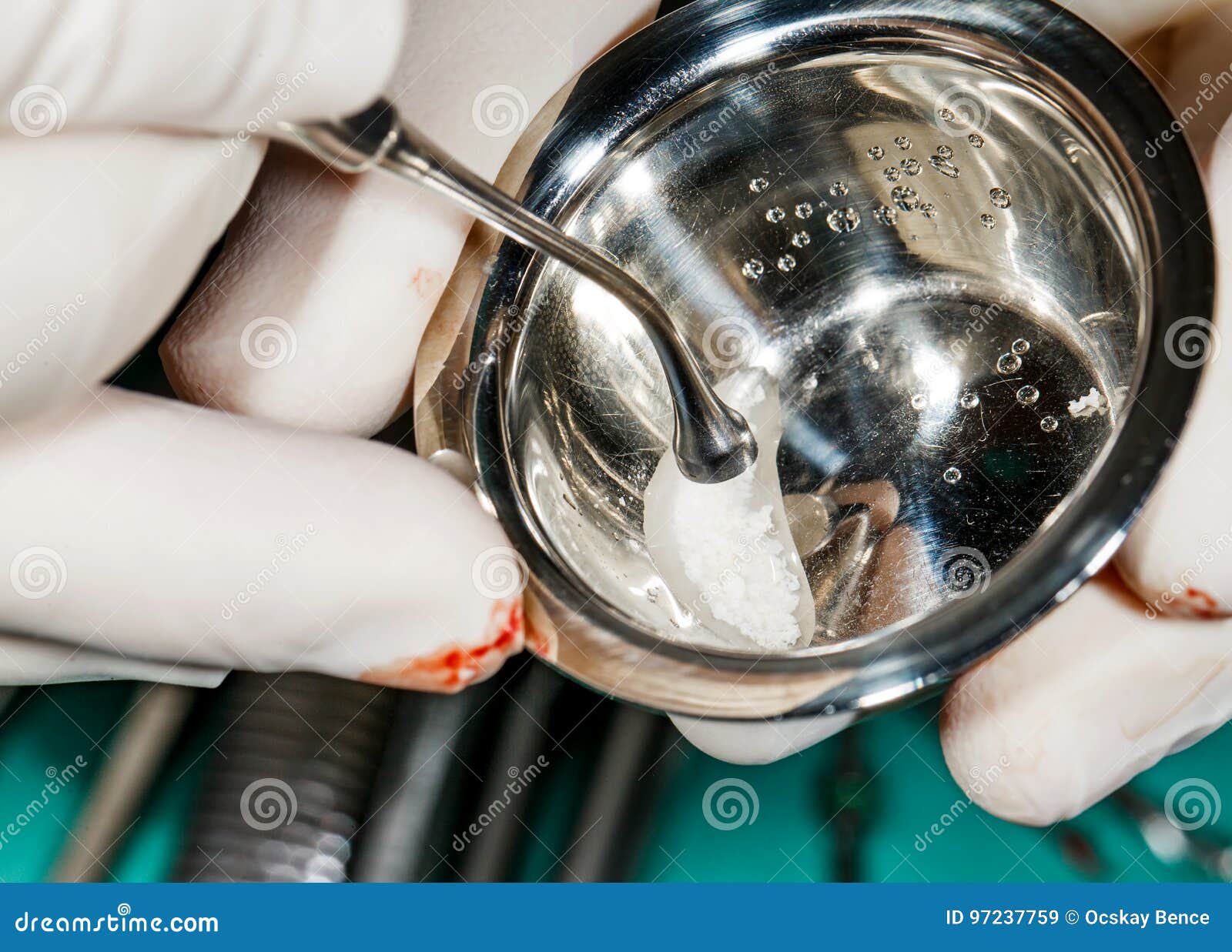 Bone Augmentation for Dental Implant Stock Image - Image of bone ...
