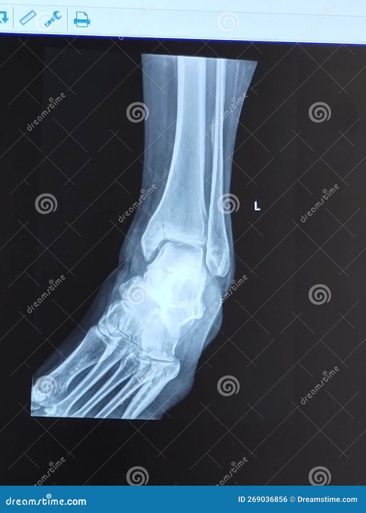 Bone broke x-ray foot stock photo. Image of bone, xray - 269036856