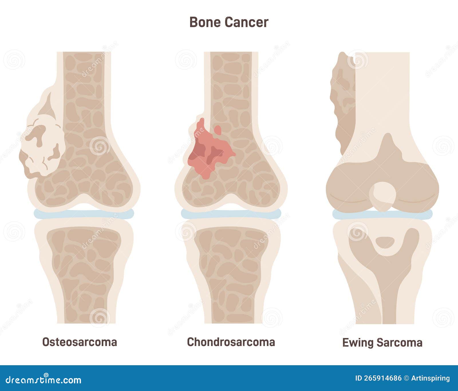 Bone Cancer Types Set. Ewing S Sarcoma, Osteosarcoma and Chondrosarcoma Stock Vector ...