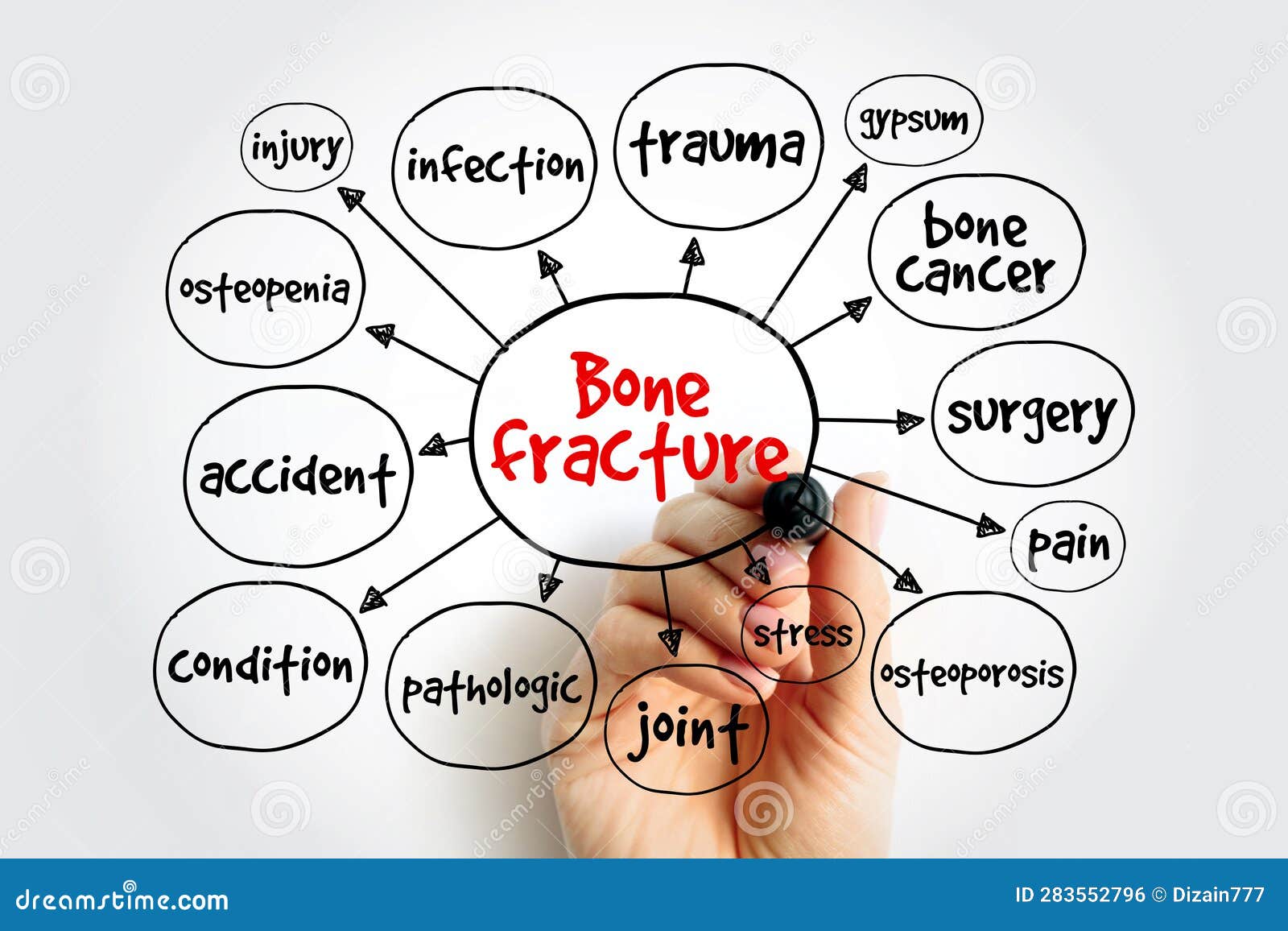 Bone Fracture Mind Map, Concept For Presentations And Reports Stock ...