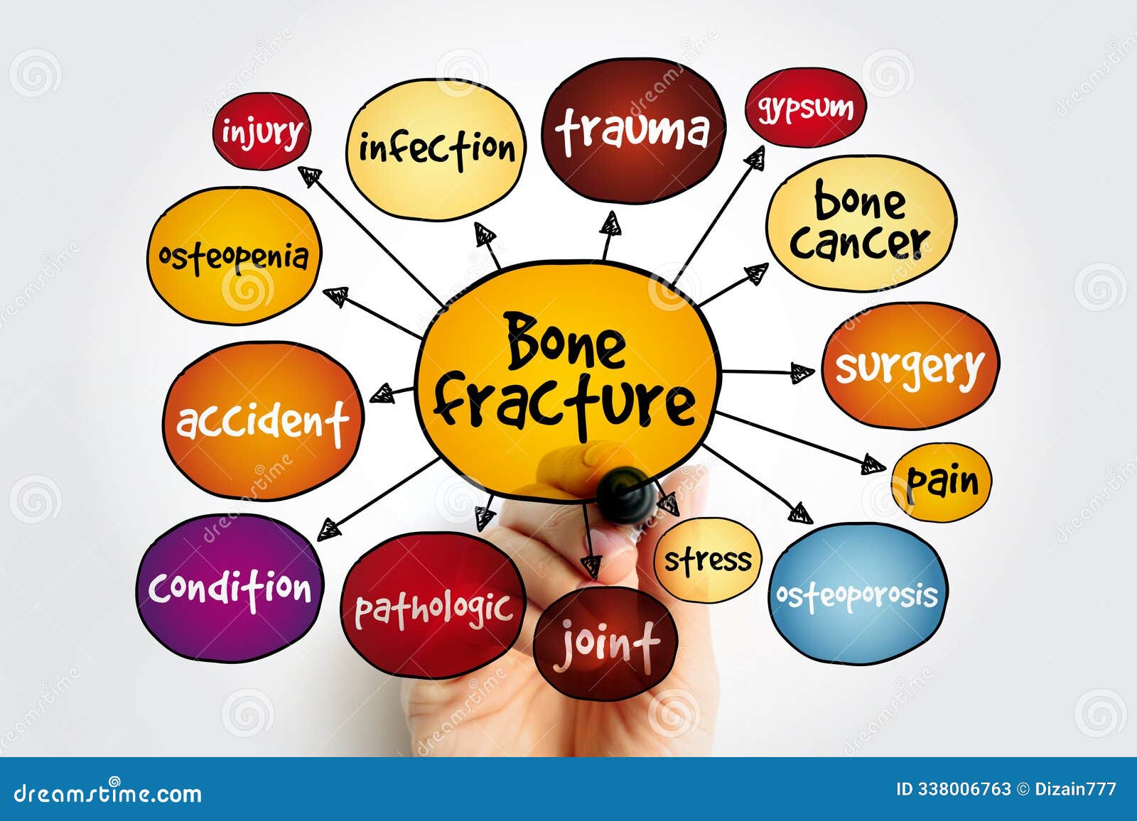 Bone Fracture Mind Map, Concept for Presentations and Reports Stock ...