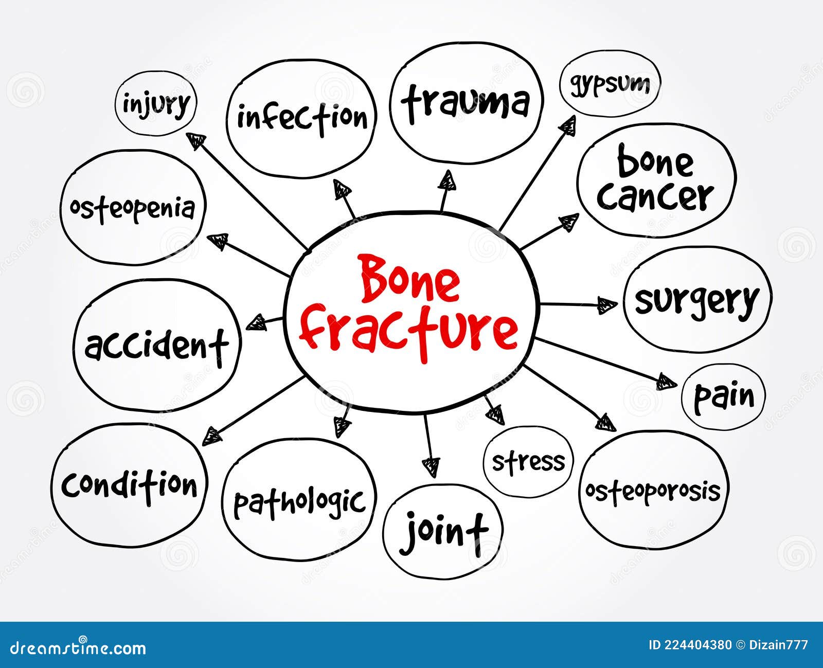 Bone Fracture Mind Map, Concept For Presentations And Reports Stock ...