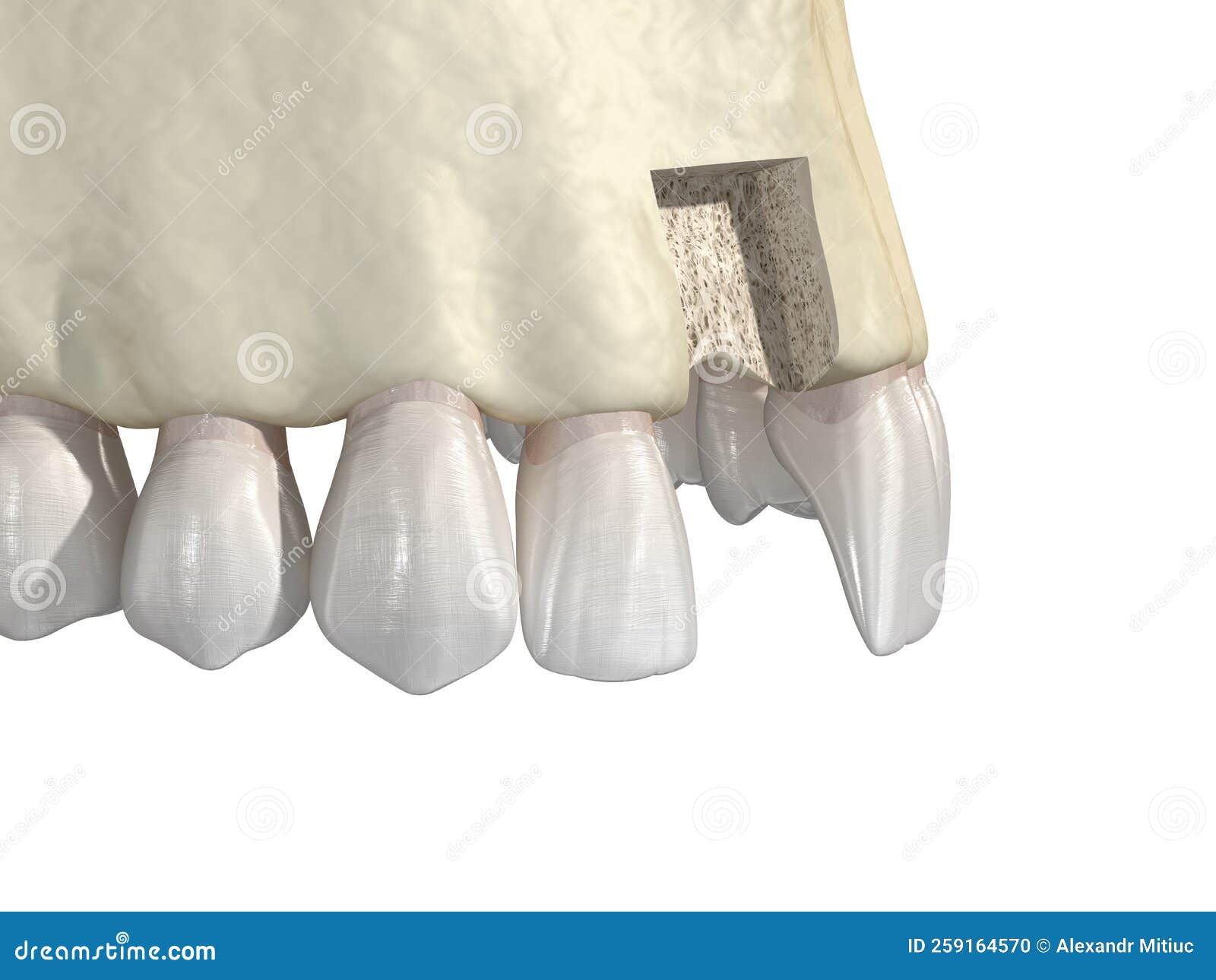 Bone Grafting- Augmentation Using Block of Bone, Tooth Implantation ...