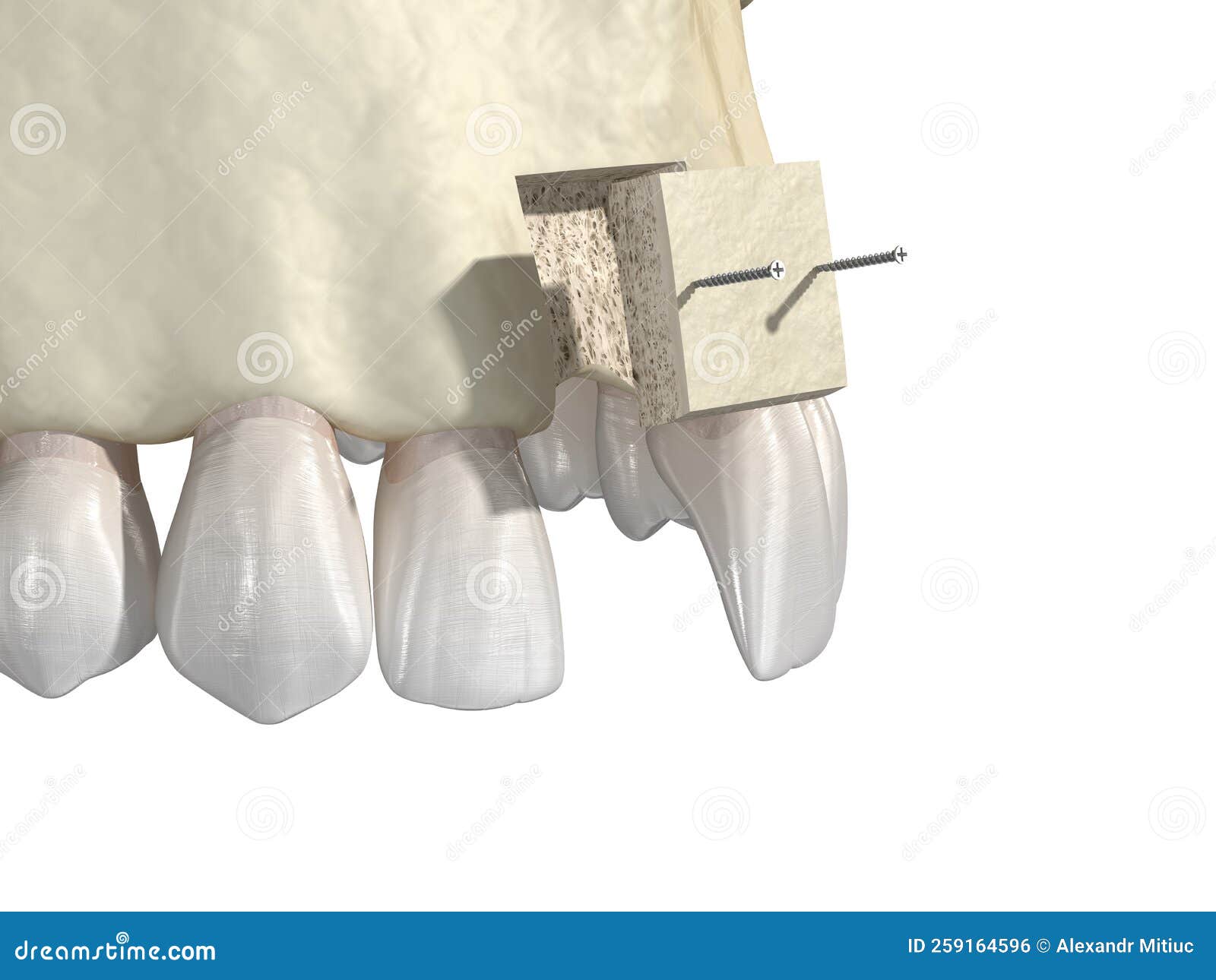 Bone Grafting- Augmentation Using Block Of Bone, Tooth Implantation ...