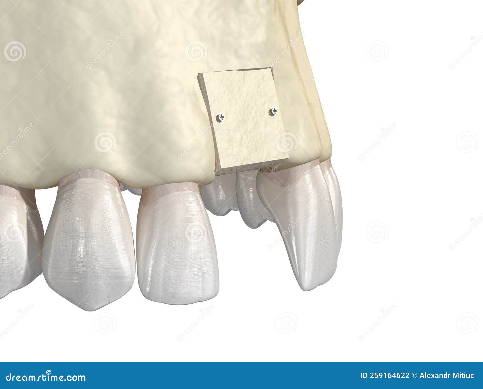 Bone Grafting- Augmentation Using Block Of Bone, Tooth Implantation ...
