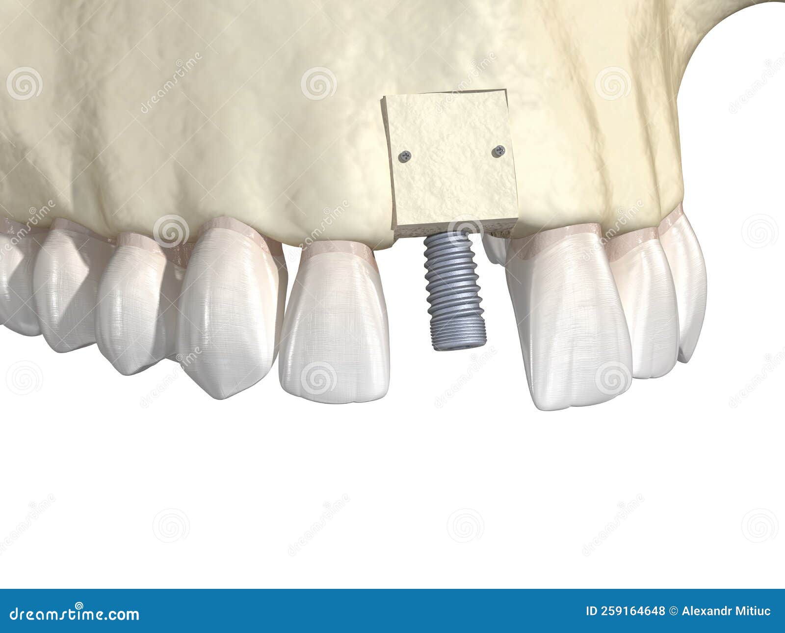 Bone Grafting- Augmentation Using Block of Bone, Tooth Implantation ...