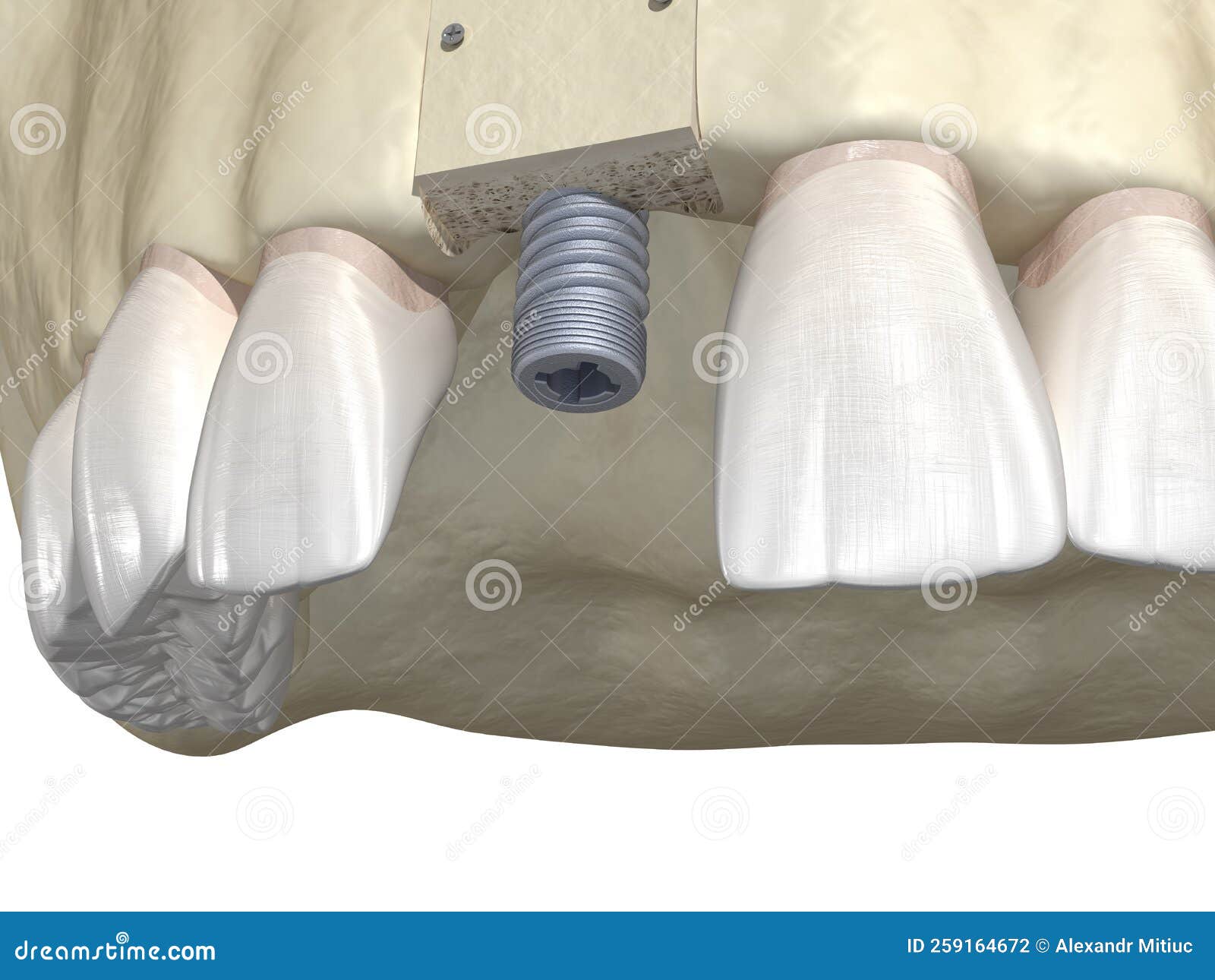 Bone Grafting- Augmentation Using Block Of Bone, Tooth Implantation ...