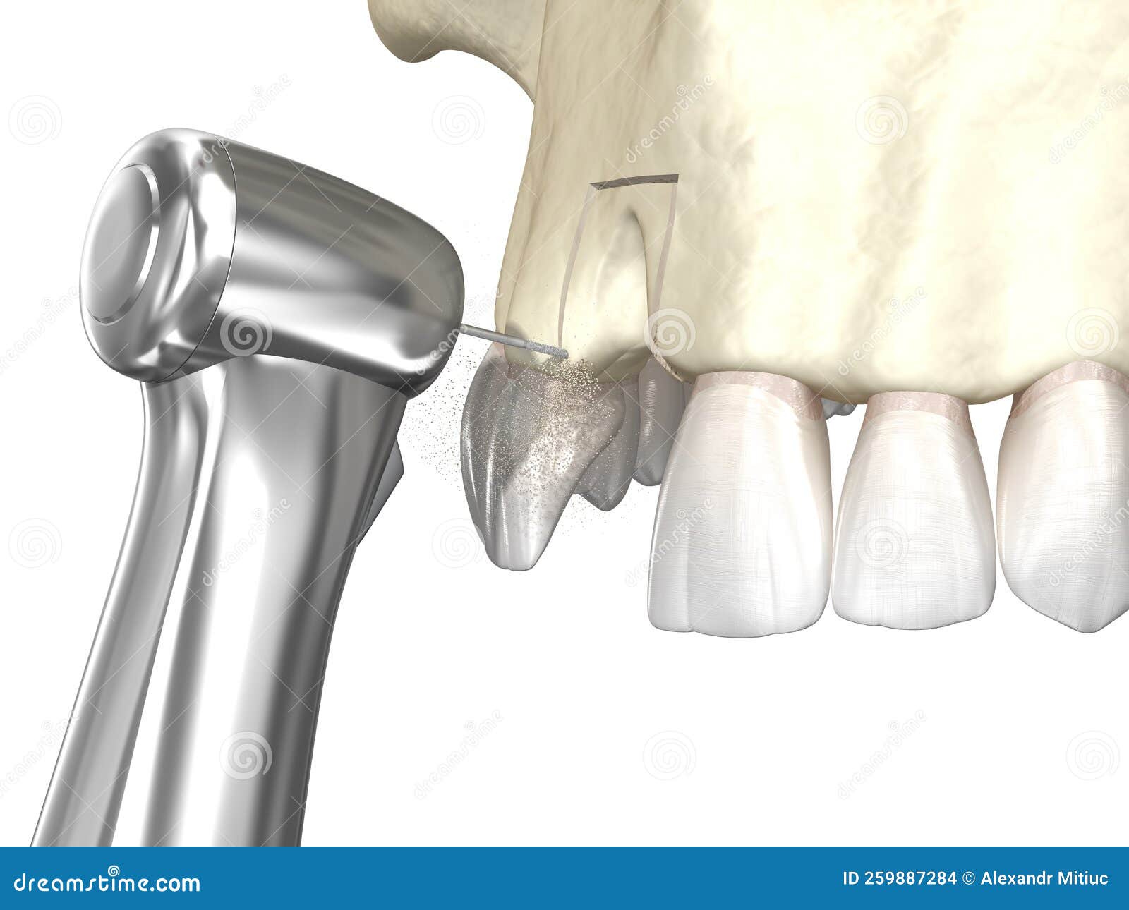 Bone Grafting- Augmentation Using Block Of Bone, Tooth Implantation ...