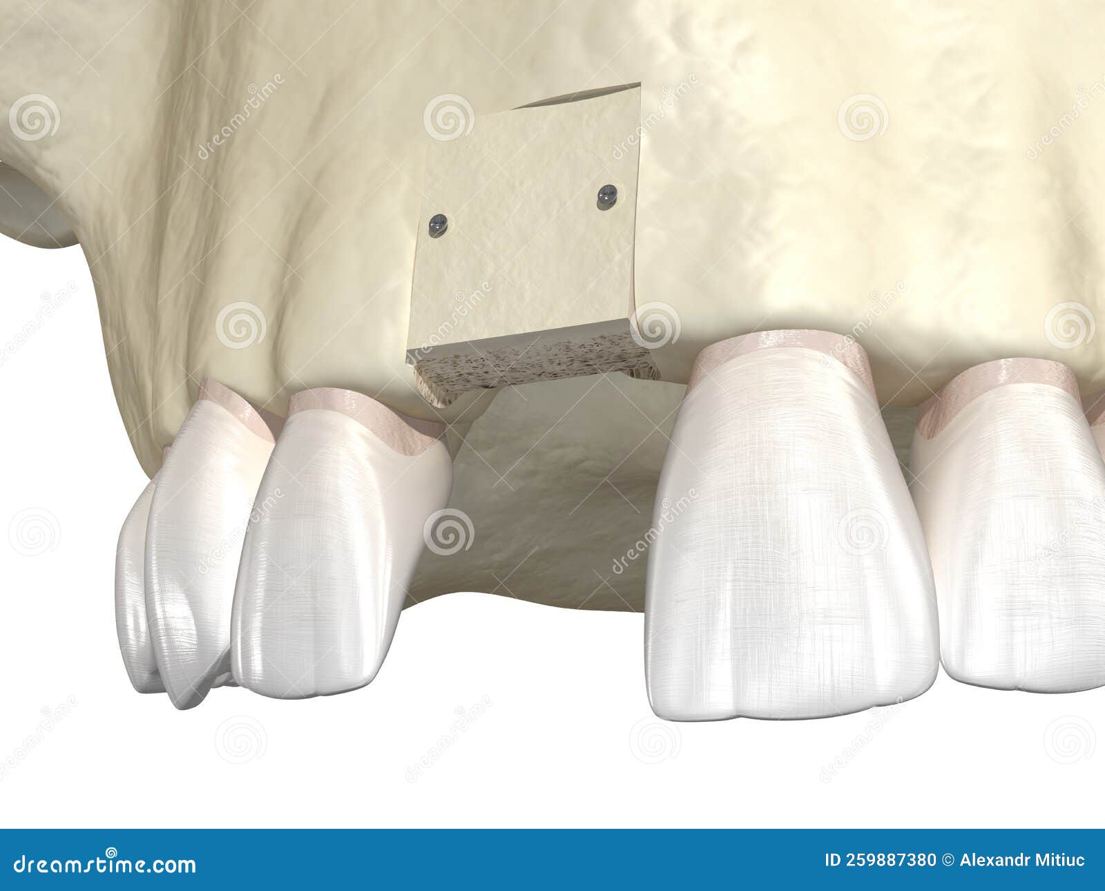 Bone Grafting- Augmentation Using Block Of Bone, Tooth Implantation ...