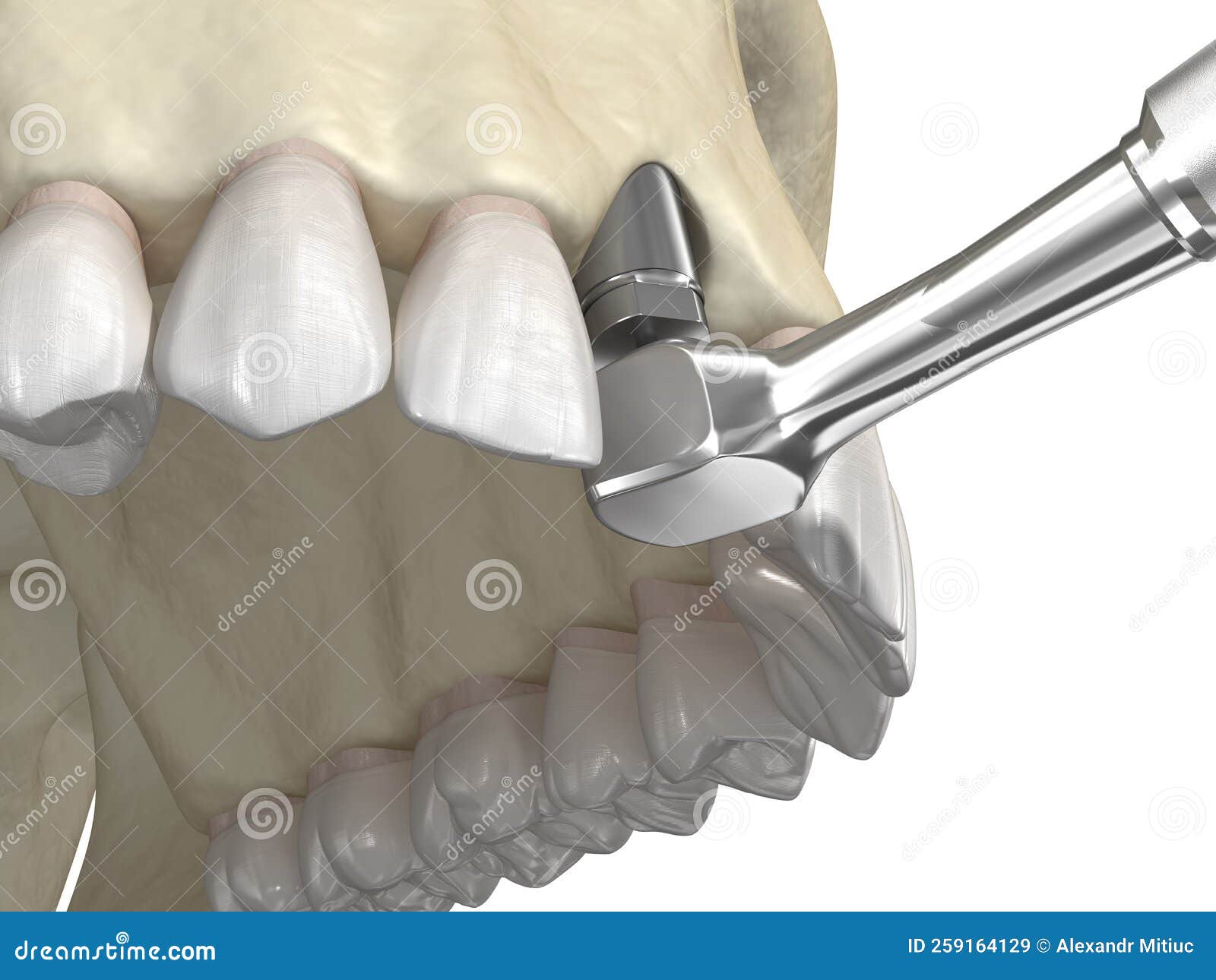 Bone Grafting- Augmentation Using Ring Method, Tooth Implantation ...