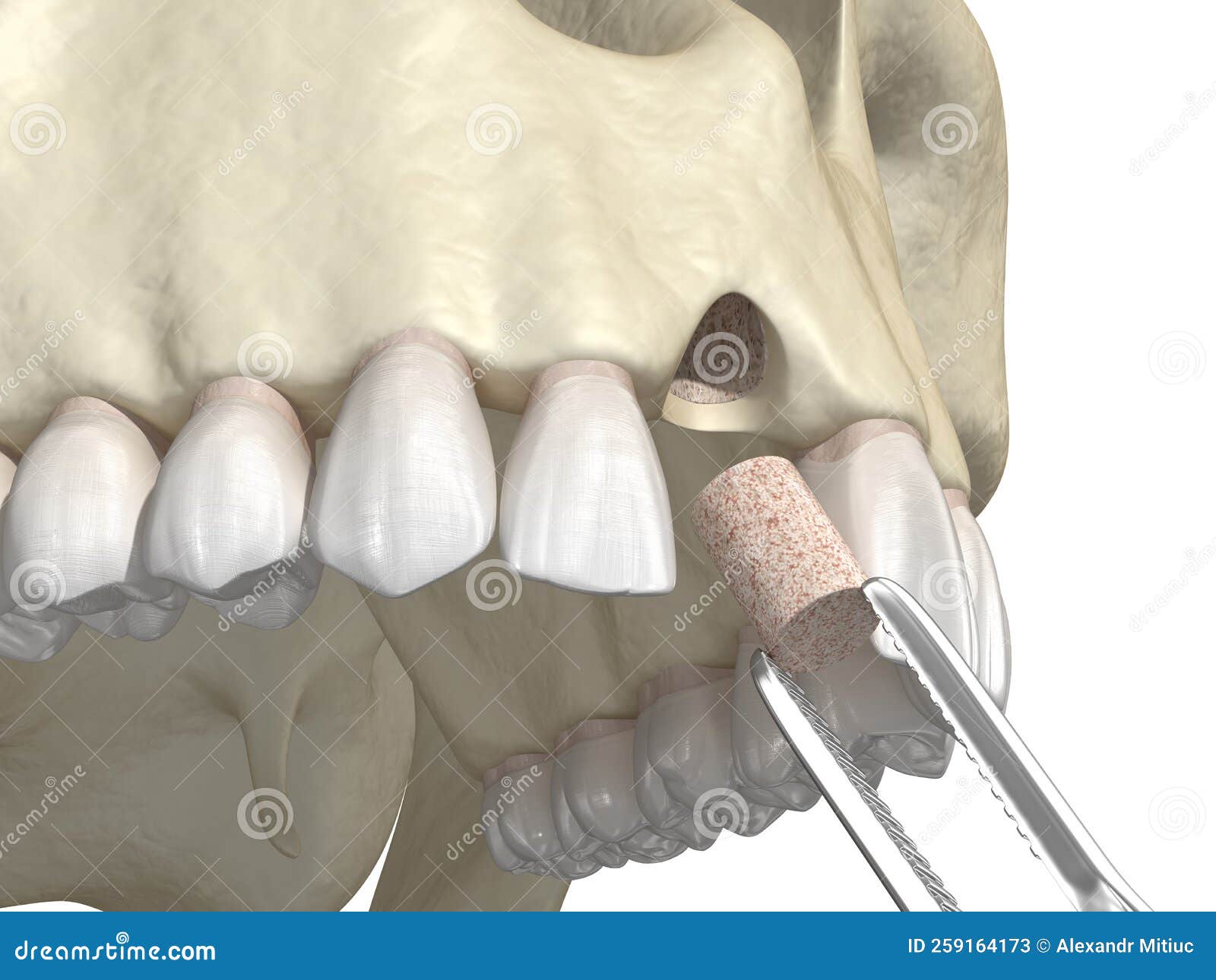 Bone Grafting- Augmentation Using Ring Method, Tooth Implantation ...
