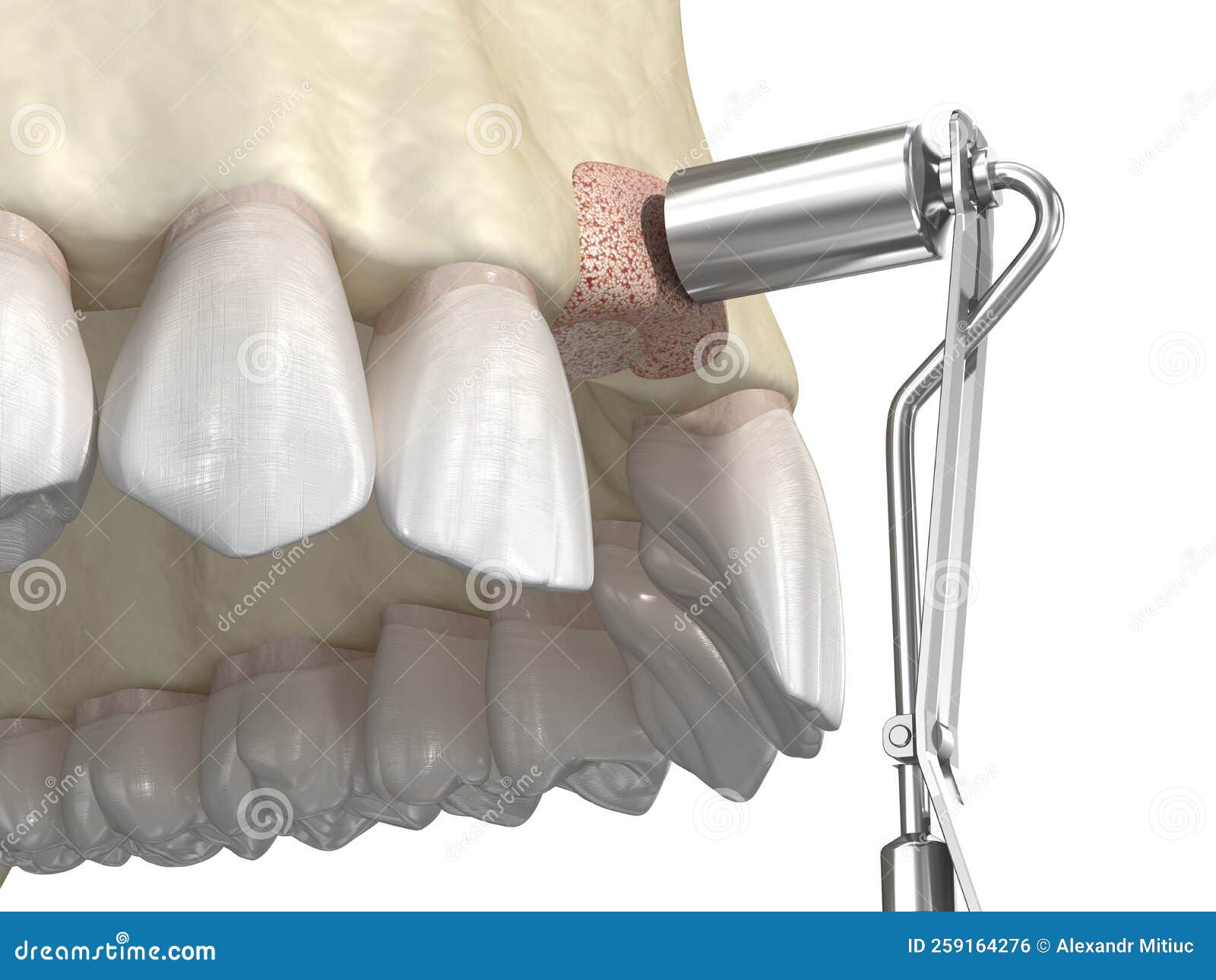 Bone Grafting- Augmentation Using Ring Method, Tooth Implantation ...