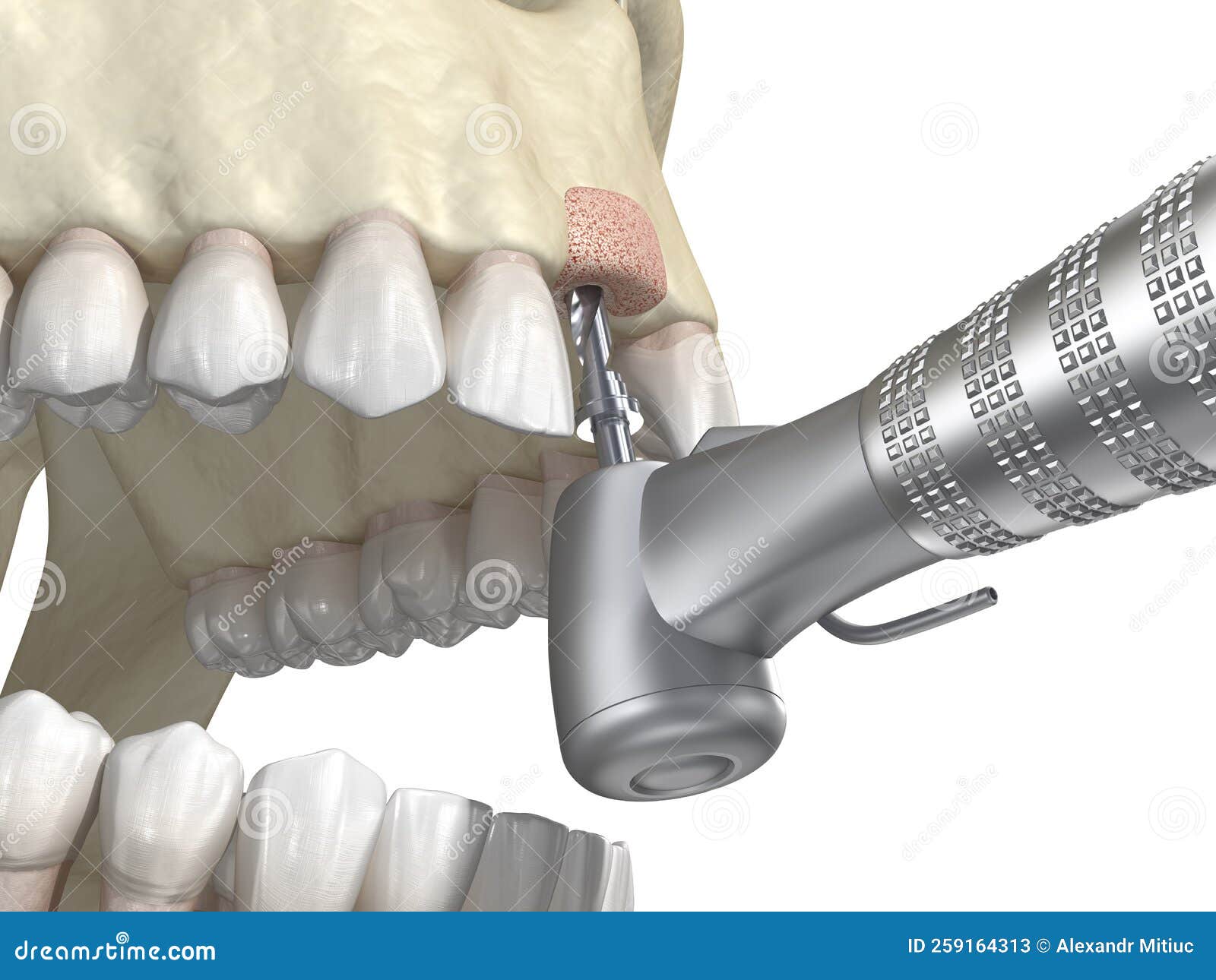 Bone Grafting- Augmentation Using Ring Method, Tooth Implantation ...