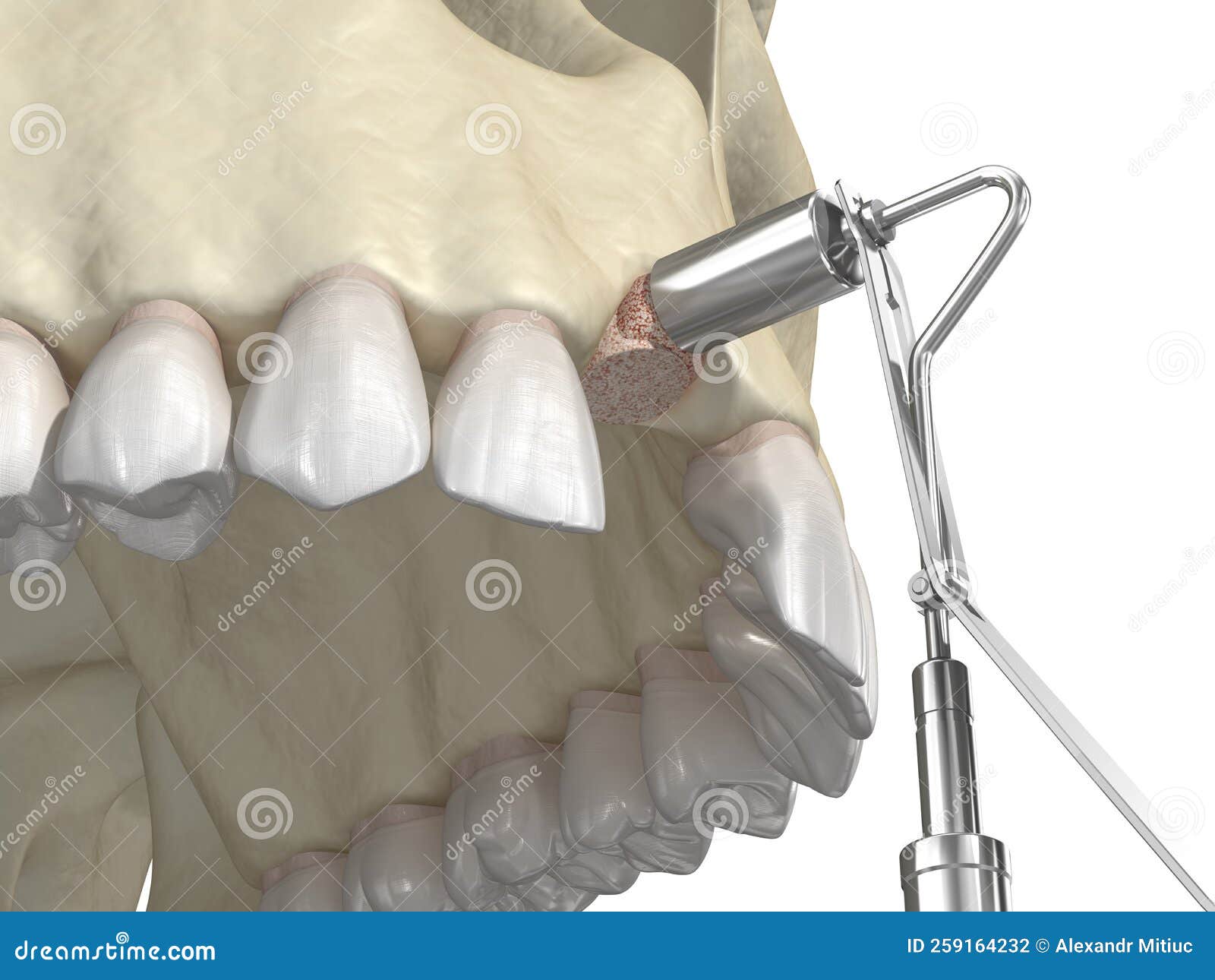 Bone Grafting- Augmentation Using Ring Method, Tooth Implantation ...