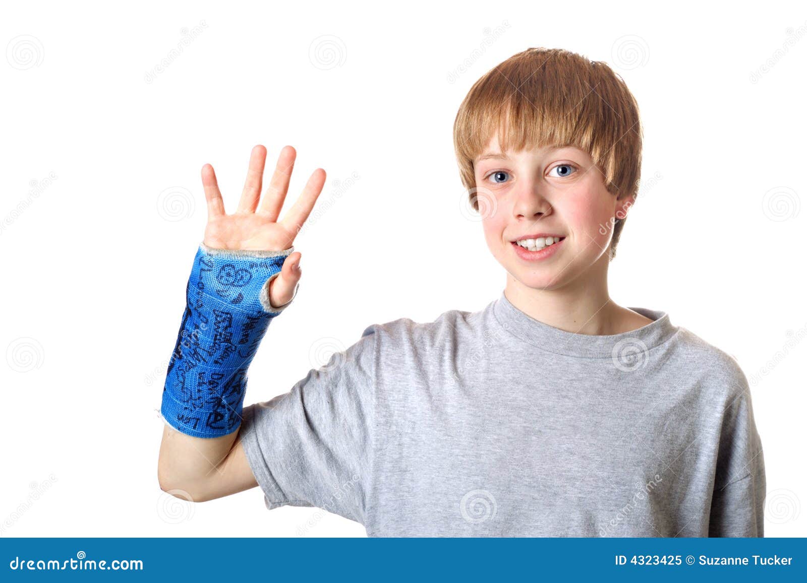 Bone Healed, Ready for the Cast To Be Taken Off Stock Image - Image of ...
