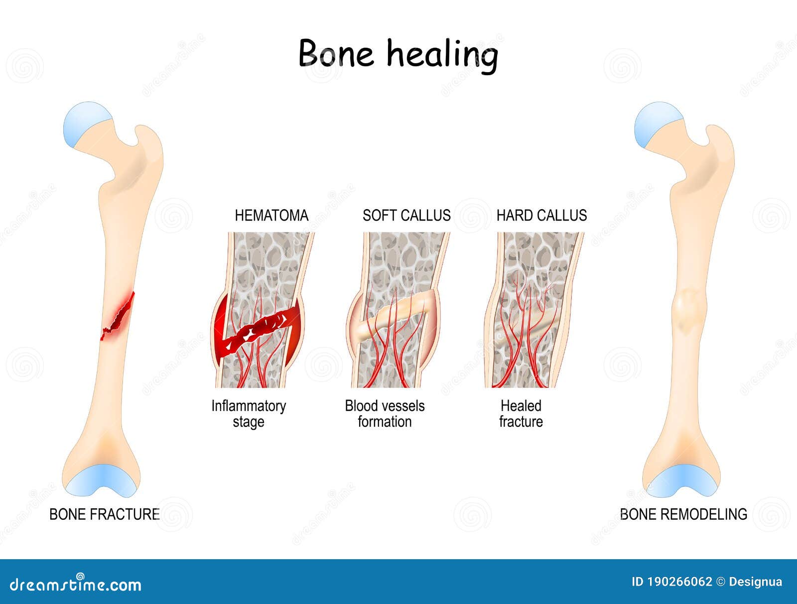 Bone Fracture Icon On Black Background. Outline Bone Icon. Vector ...