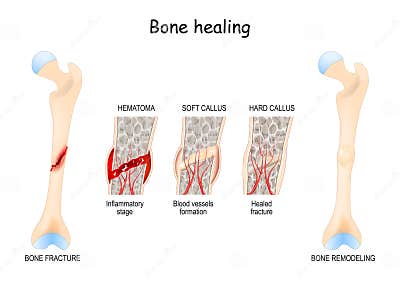 Bone Healing Process after a Bone Fracture Stock Vector - Illustration ...