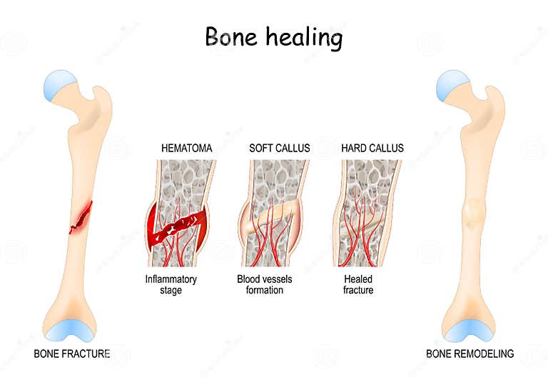 Bone Healing Process after a Bone Fracture Stock Vector - Illustration ...