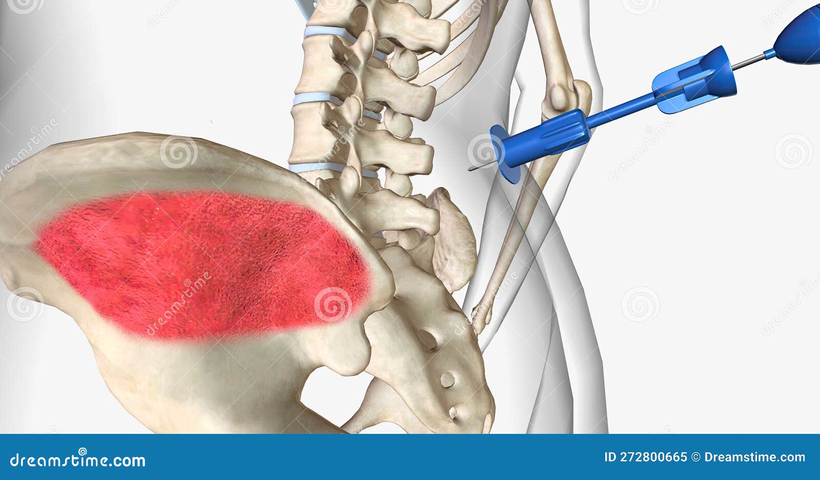 Bone Marrow Aspiration is a Procedure in Which a Liquid Bone Marrow ...