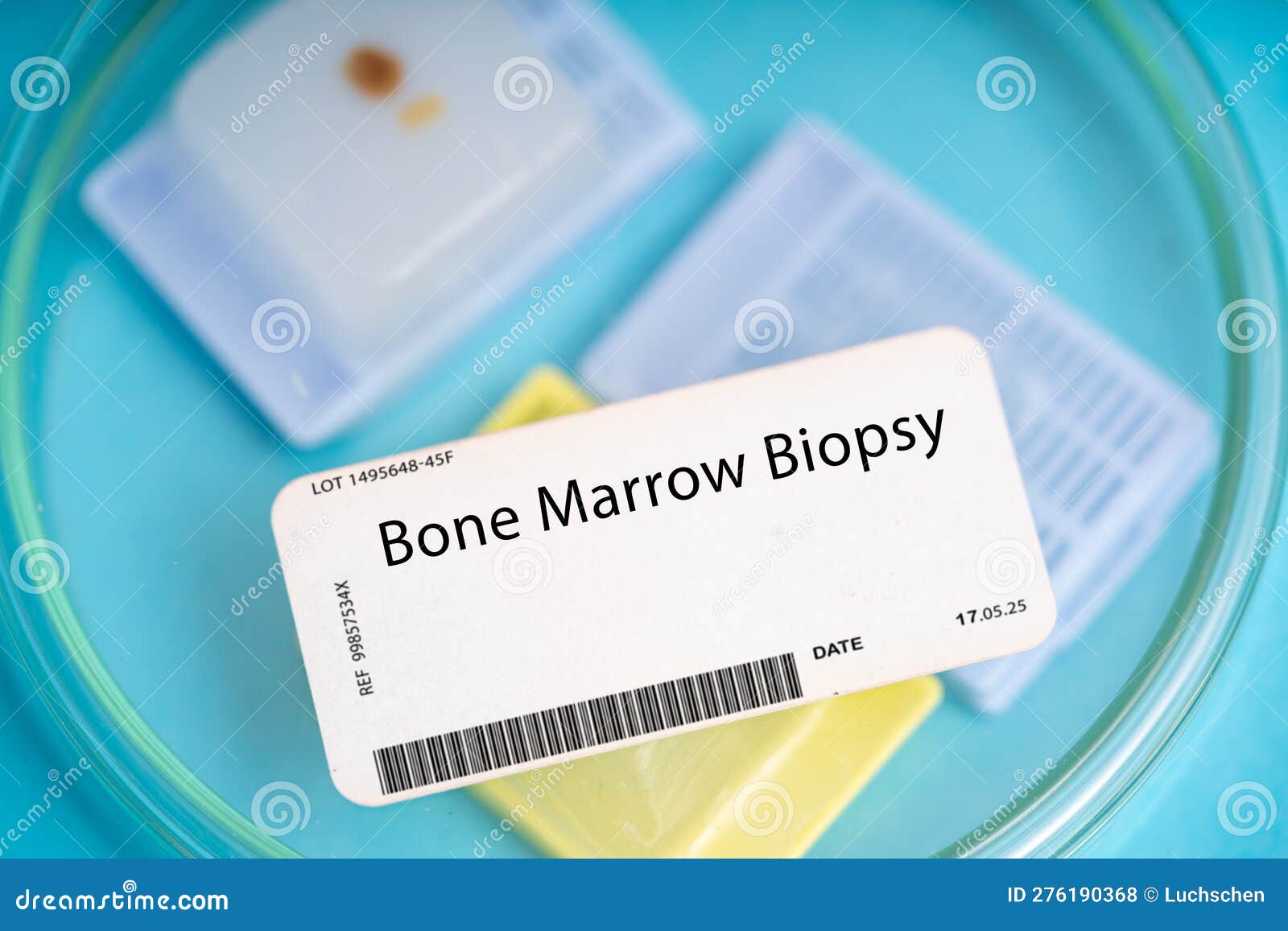 Bone Marrow Biopsy stock photo. Image of small, leukemia - 276190368