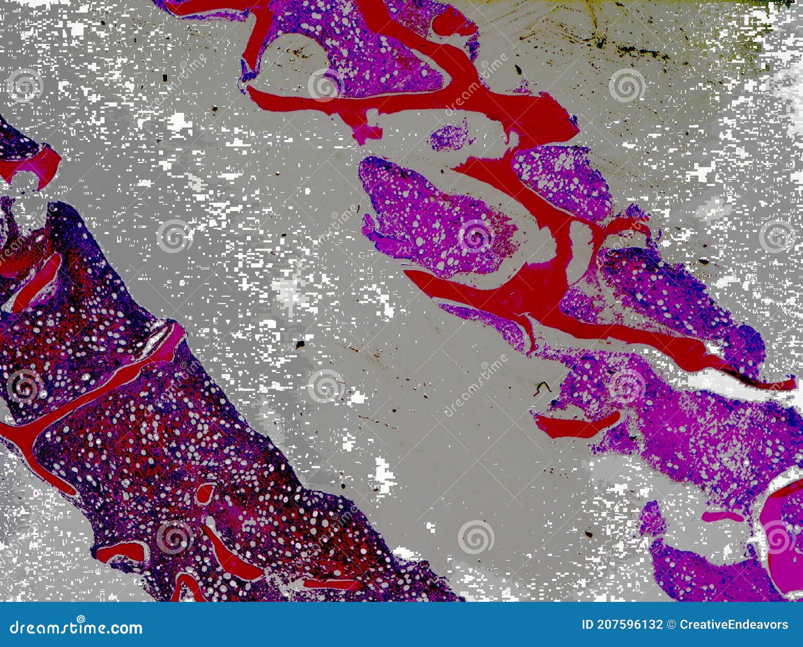 Bone Marrow Core Biopsy Pathology Sections - H and E Stain Stock Photo ...