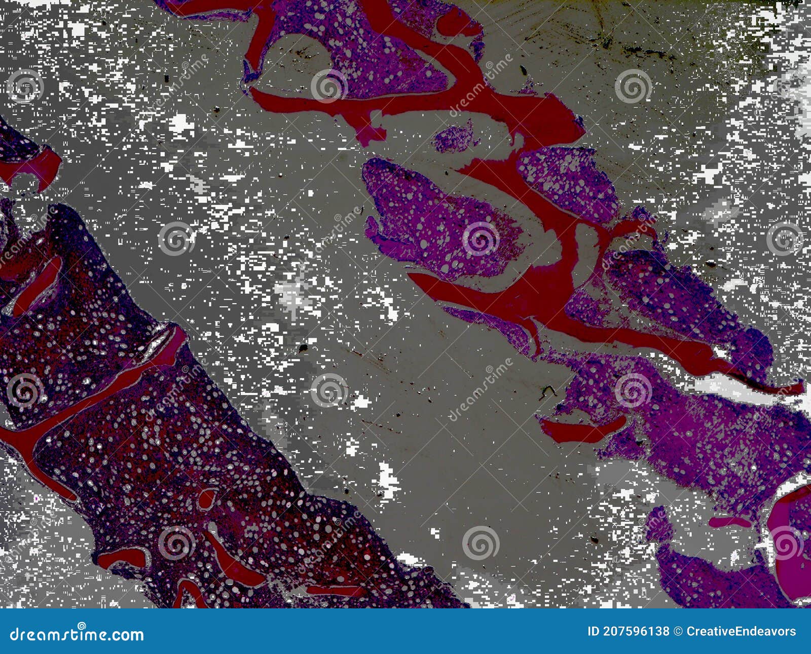 Bone Marrow Core Biopsy Pathology Sections - H and E Stain Stock Photo ...