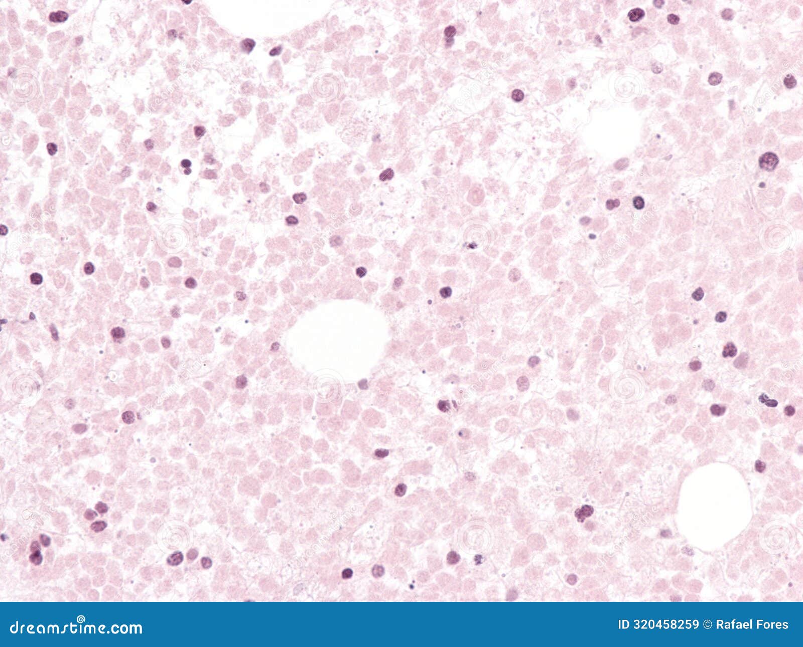 Bone Marrow Necrosis. in a Lymphoblastic Leukemia. Stock Illustration ...