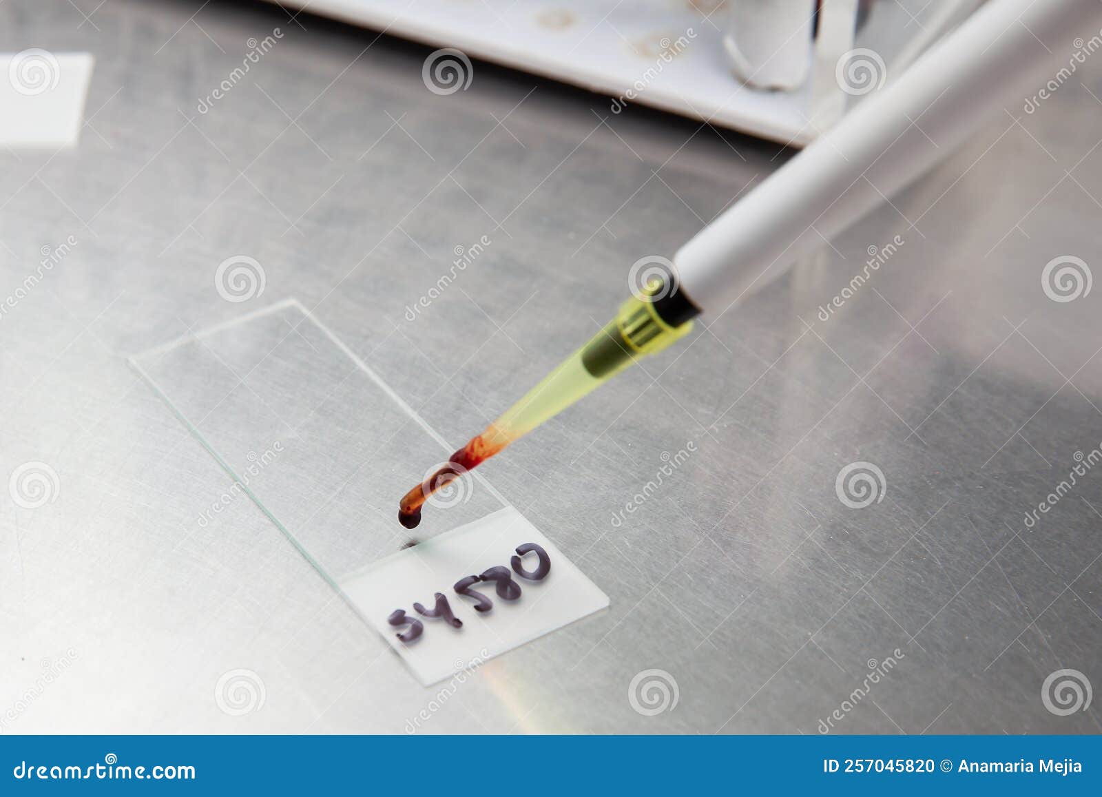 Bone Marrow Smear Preparationin the Laboratory. Blood Smear ...