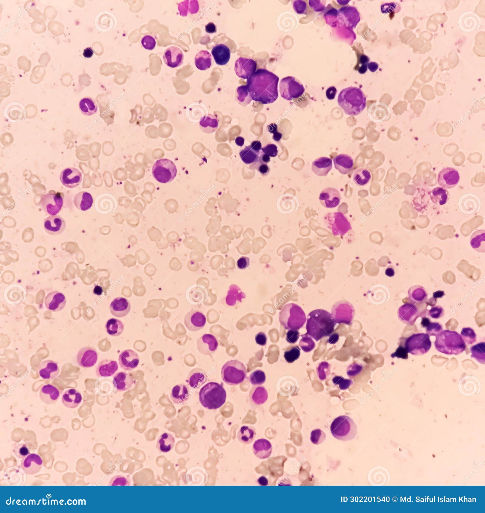 Bone Marrow Study: Dimorphic Erythroid Hyperplasia Stock Photo - Image ...