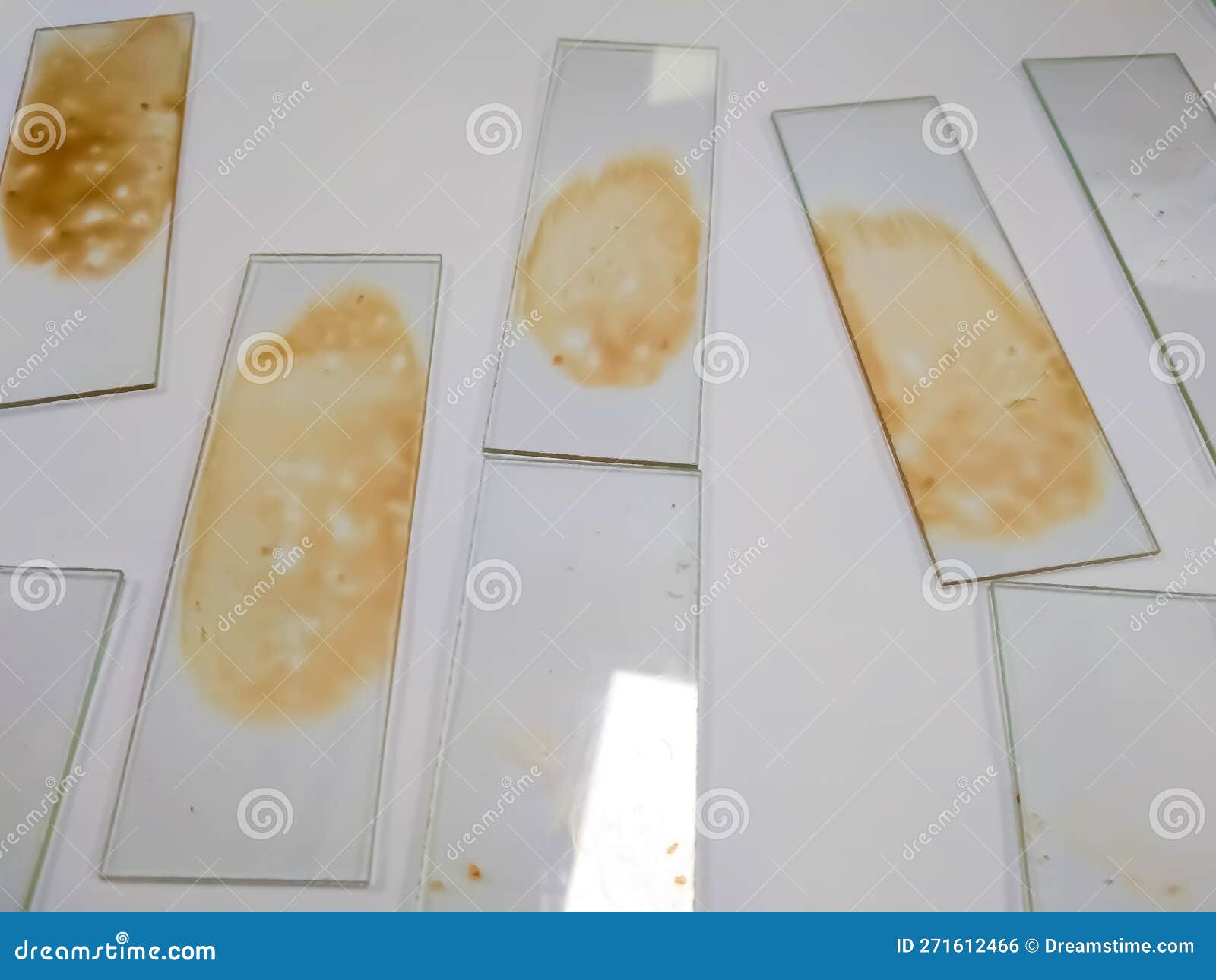 Hematological Slide Under Microscopy Showing Essential Thrombocytosis ...