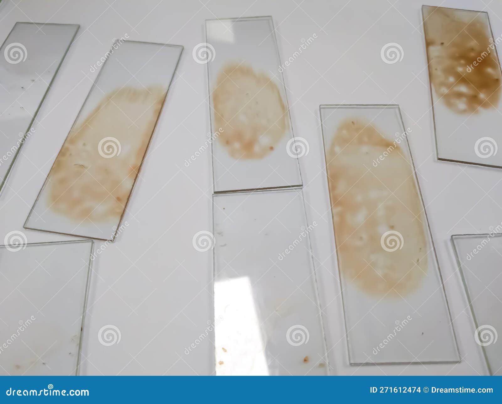 Bone Marrow Study. Microscopic Glass Slide Smear Stock Photo - Image of ... Bone Marrow Study. Microscopic Glass Slide Smear Stock Photo - Image of ...