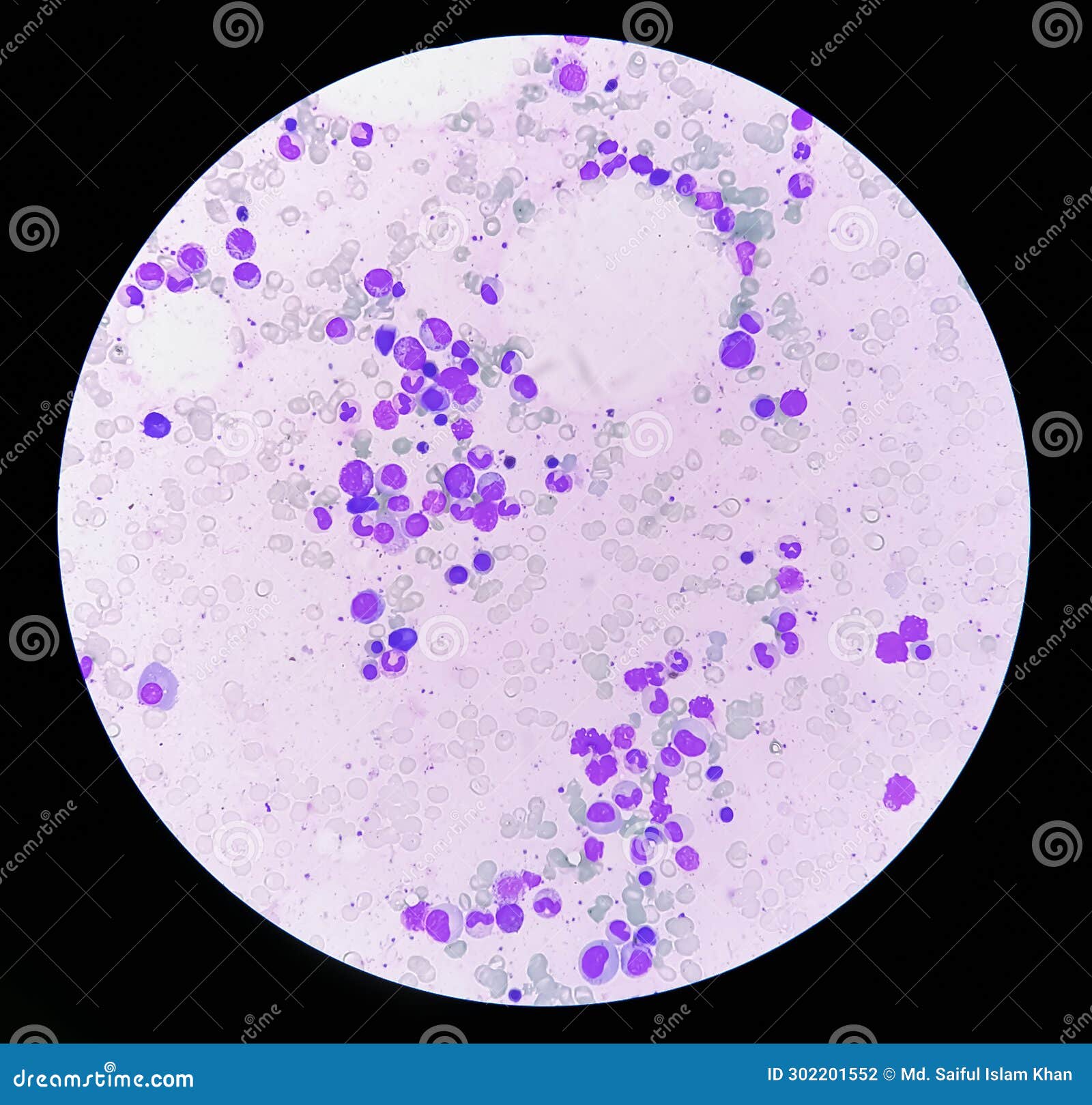 Bone Marrow Study: Suggestive of Reactive Marrow with Dimorphic ...